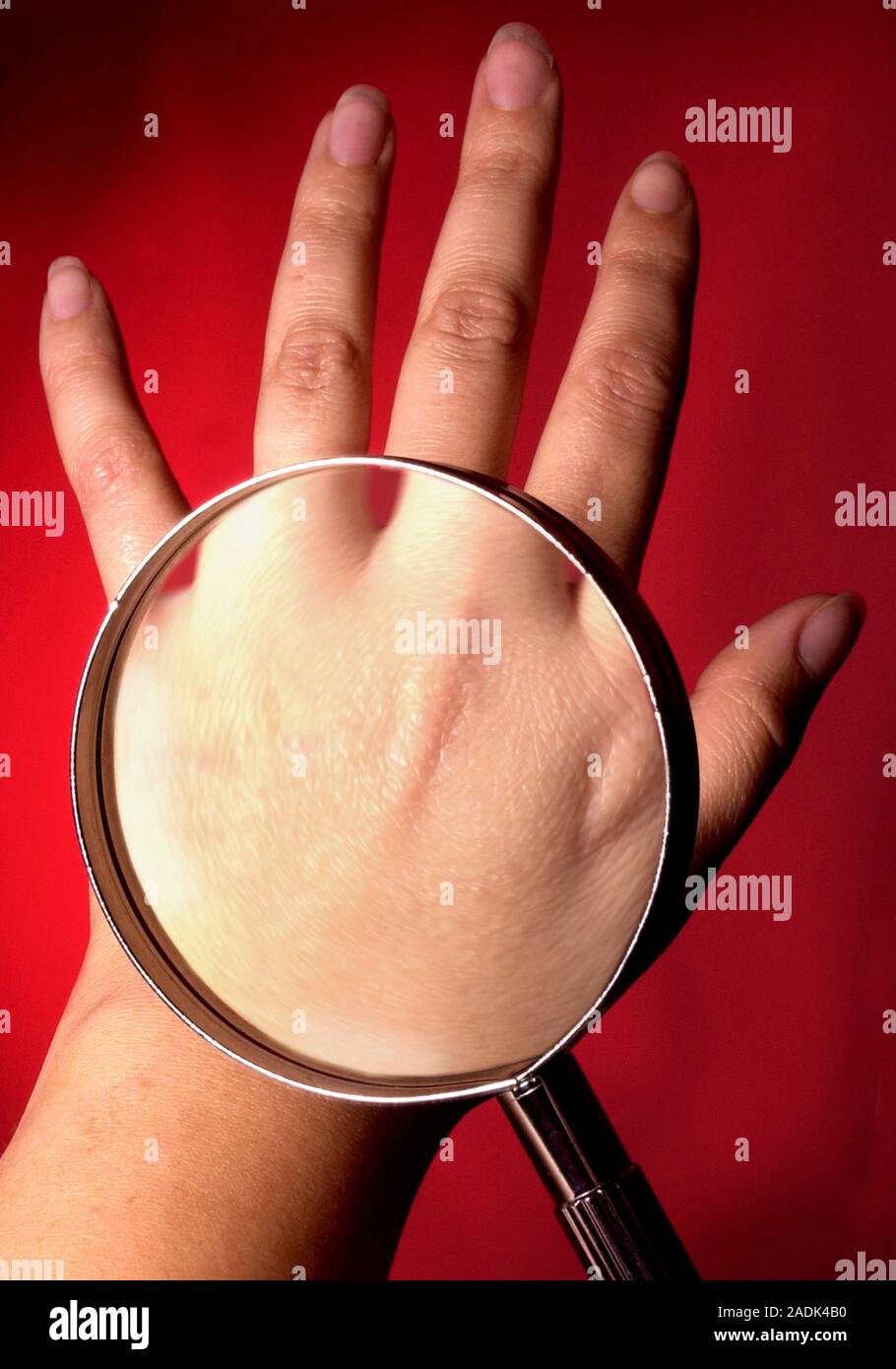 MODEL RELEASED. Dermatological examination. Magnifying glass being used ...