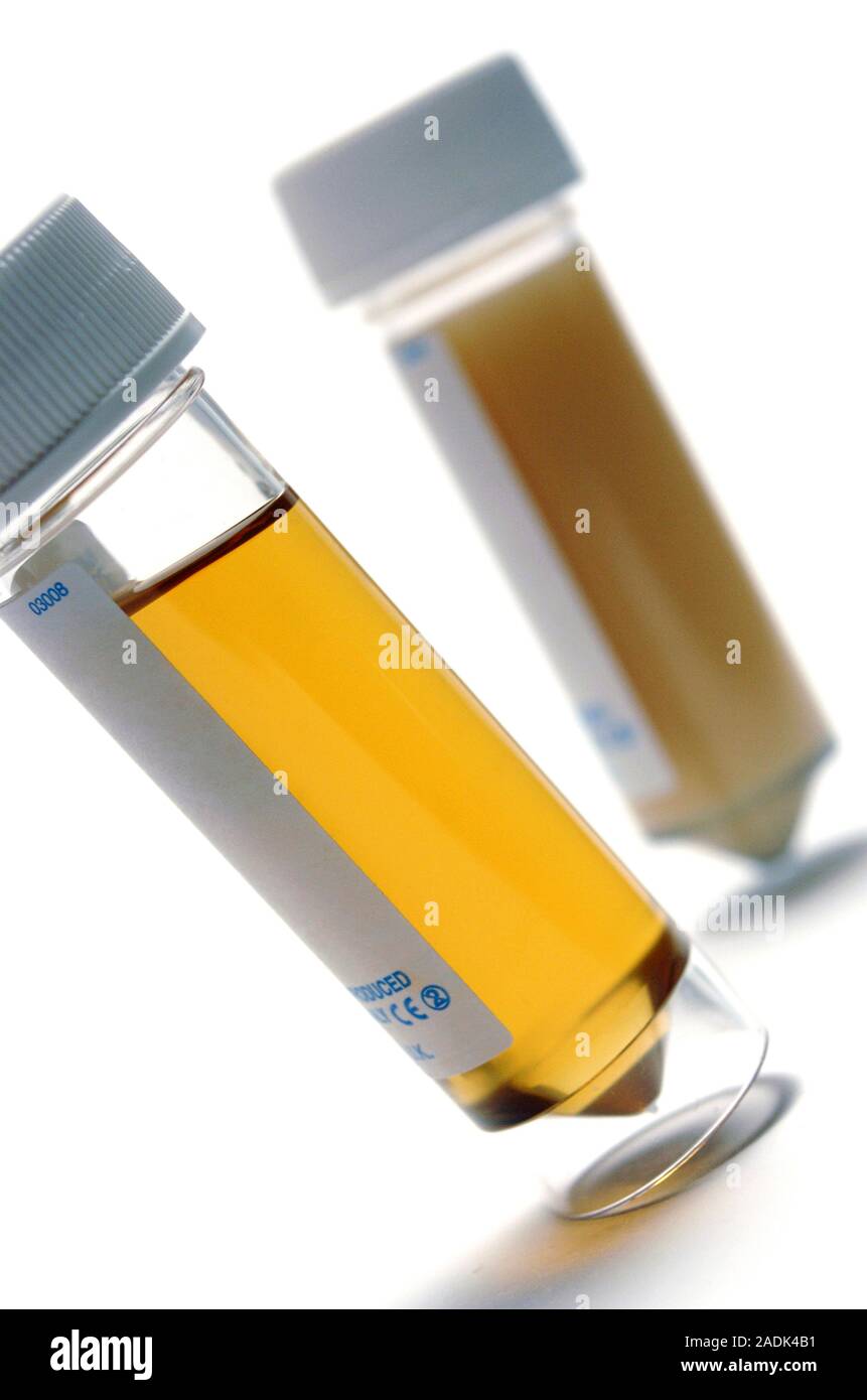 Urine samples. Two sample tubes containing specimens of urine. The ...