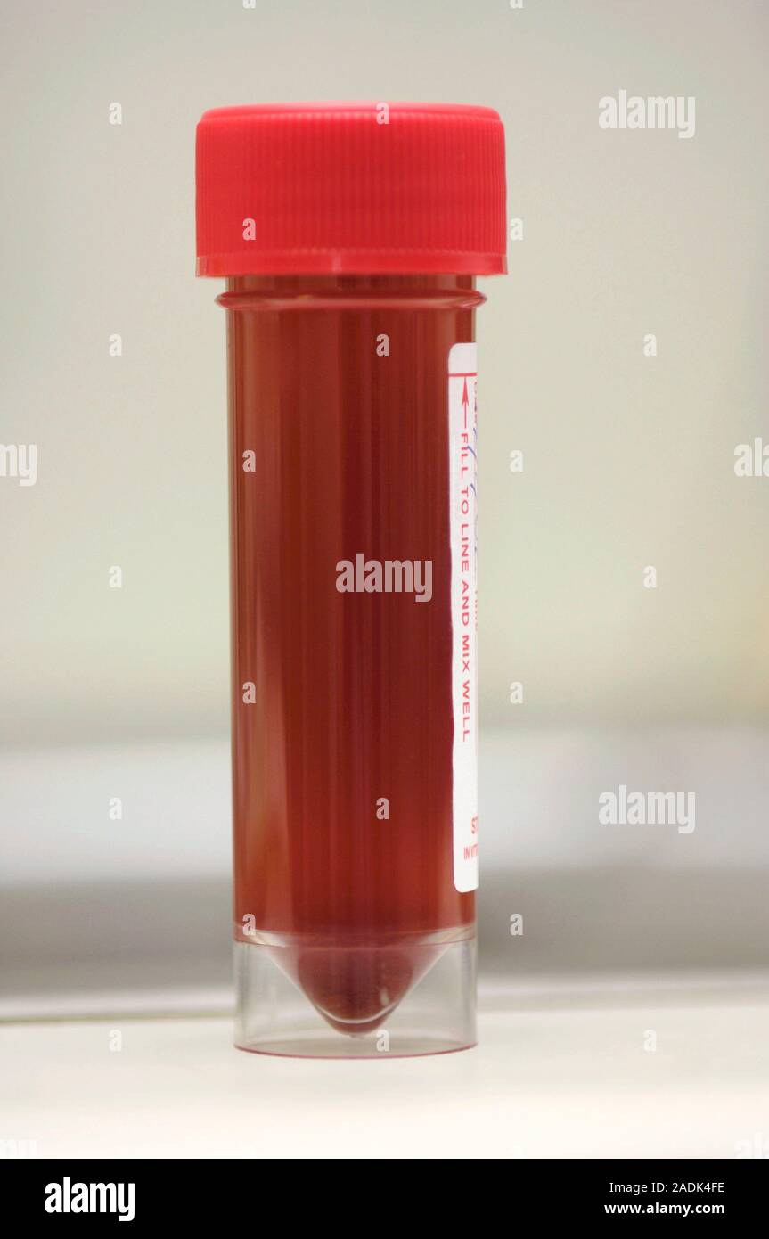 Urine sample tube containing urine mixed with blood due to bladder ...