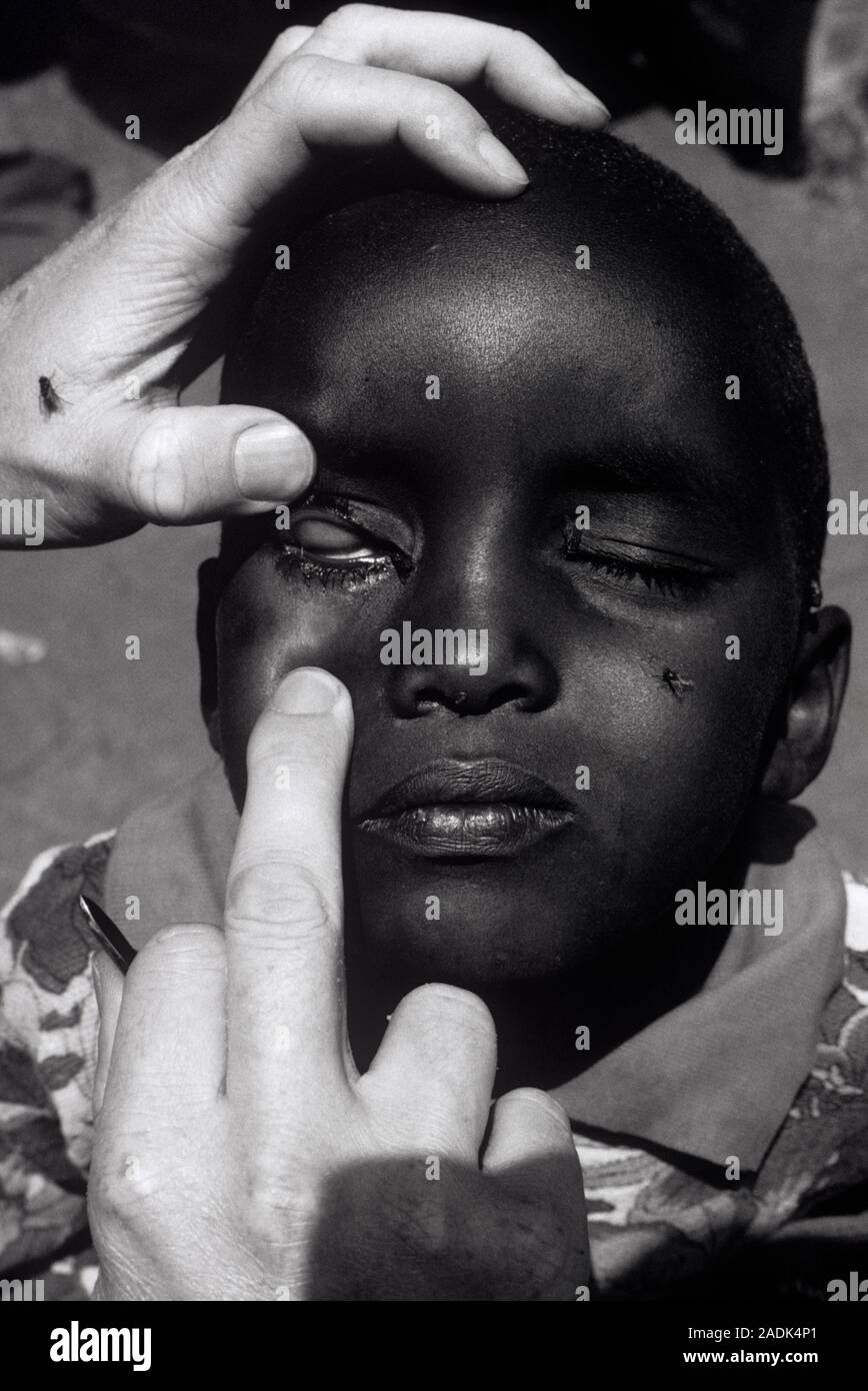 Trachoma eye infection treatment. ÂChild Âwith Âa trachoma eye ...