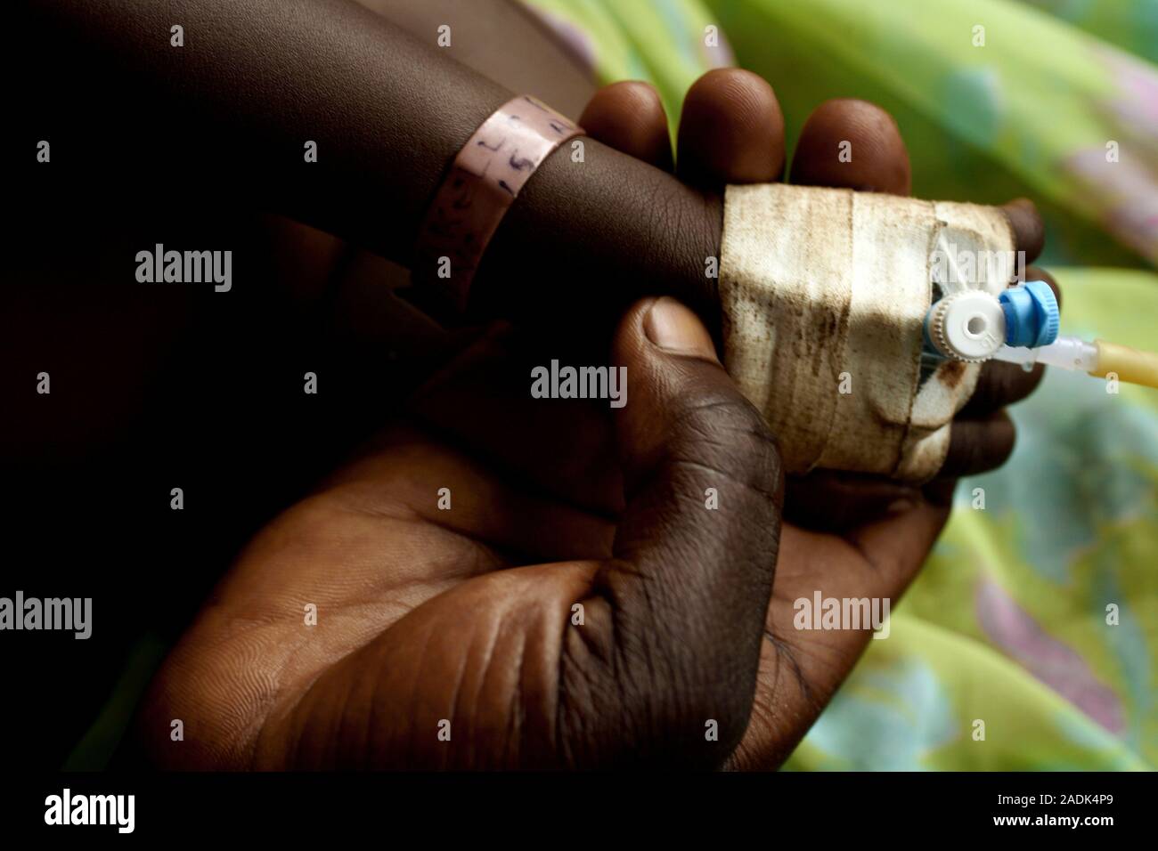 Neonatal healthcare. Cannula in the hand of a newborn baby. The baby's ...