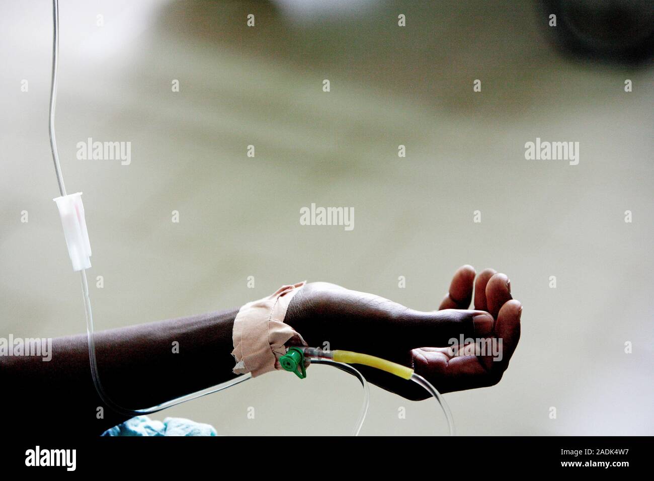 MODEL RELEASED. Patient with an intravenous drip. Drip tubing attached ...