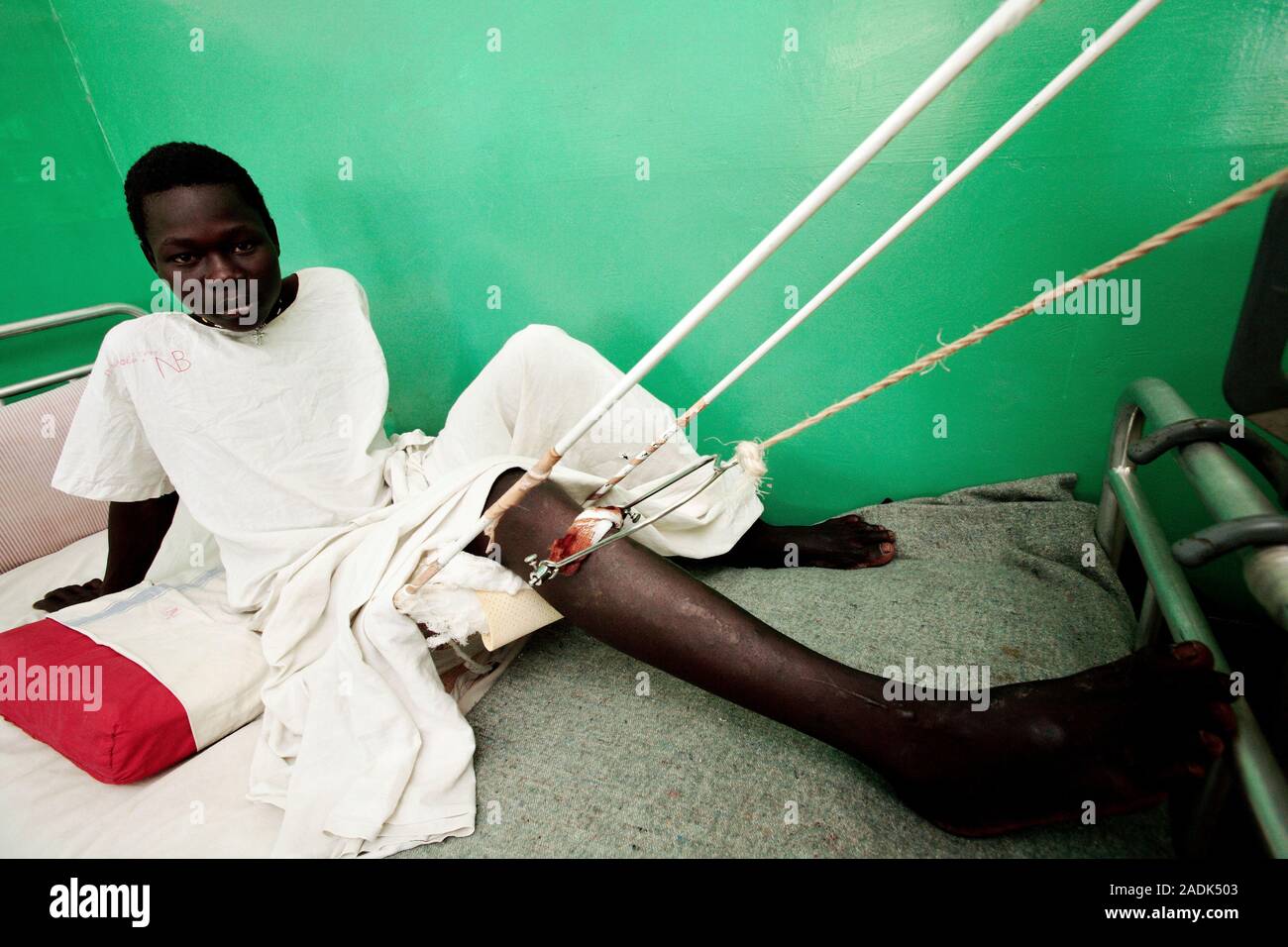 MODEL RELEASED. Child with leg in traction. This child's injured leg is ...