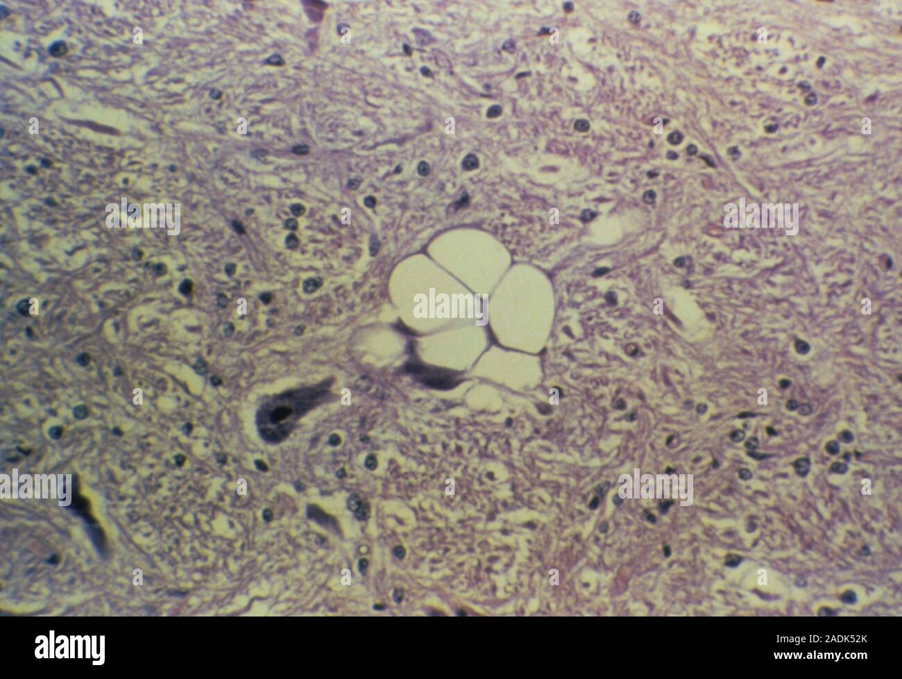 Mad cow brain. Light micrograph of a section through brain tissue of a ...