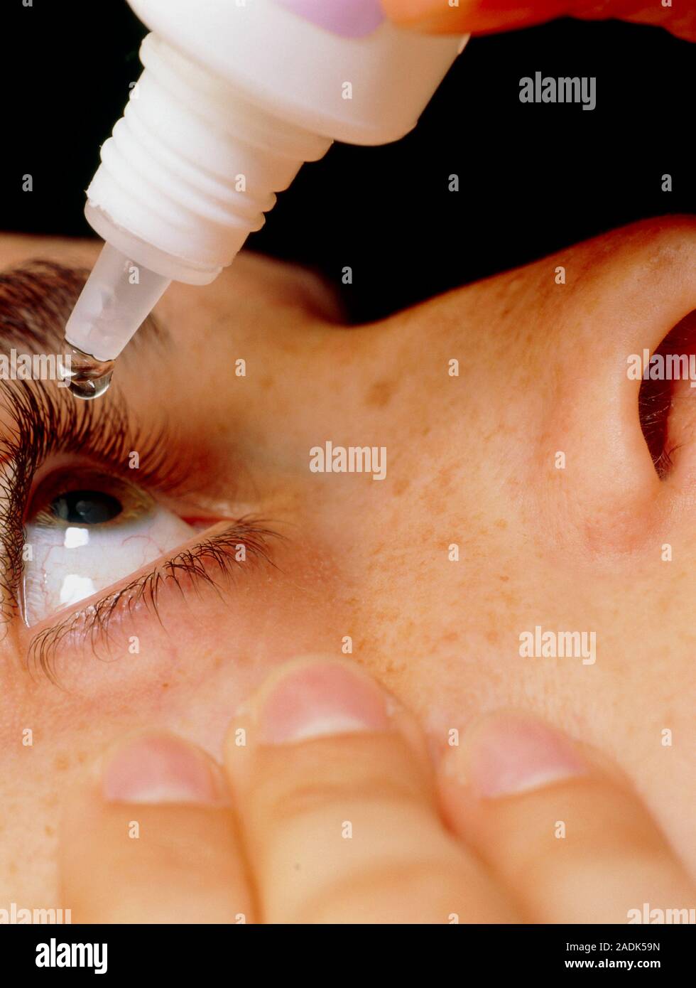 Eye drops. Close-up of a woman applying eye drops to her eye. Eye drops ...