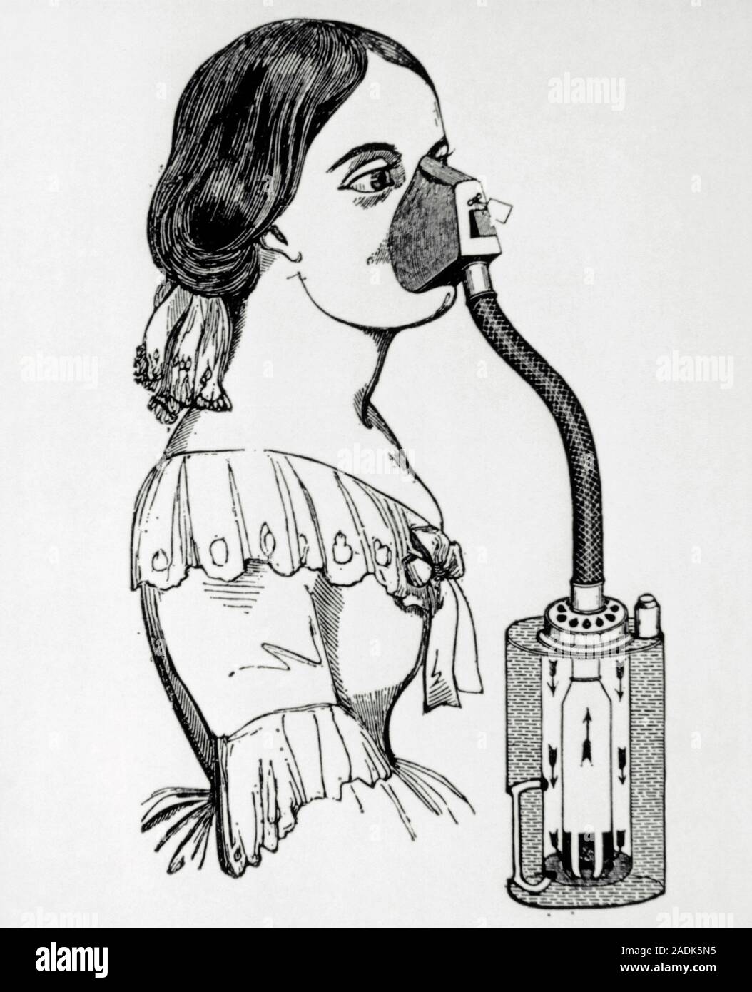 Chloroform inhaler. Illustration of a chloroform inhaler used in the ...