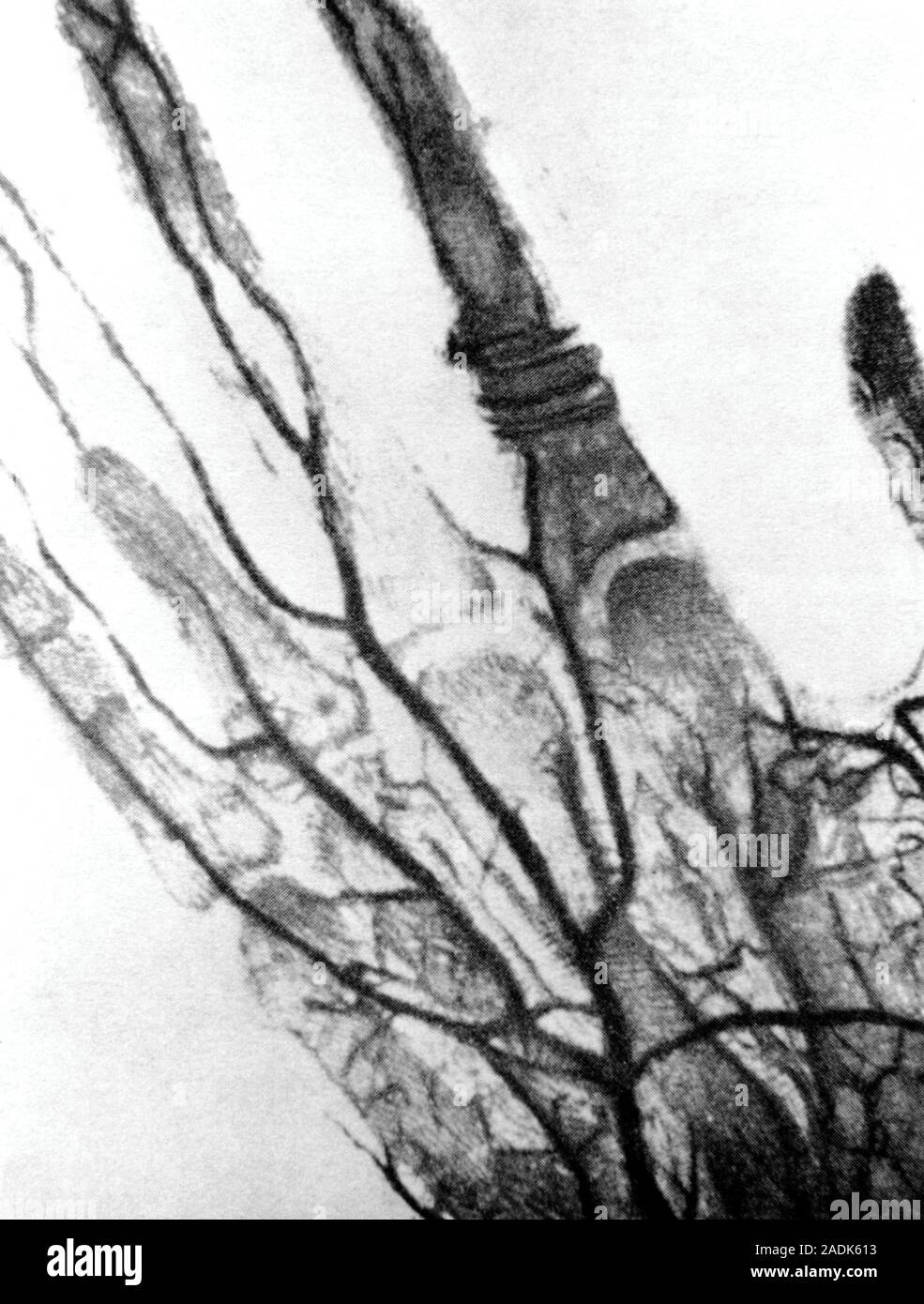 The first angiogram. View of the first angiogram showing the hand's ...