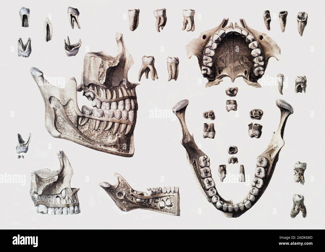 Dental anatomy. Historical anatomical artwork of healthy and diseased ...