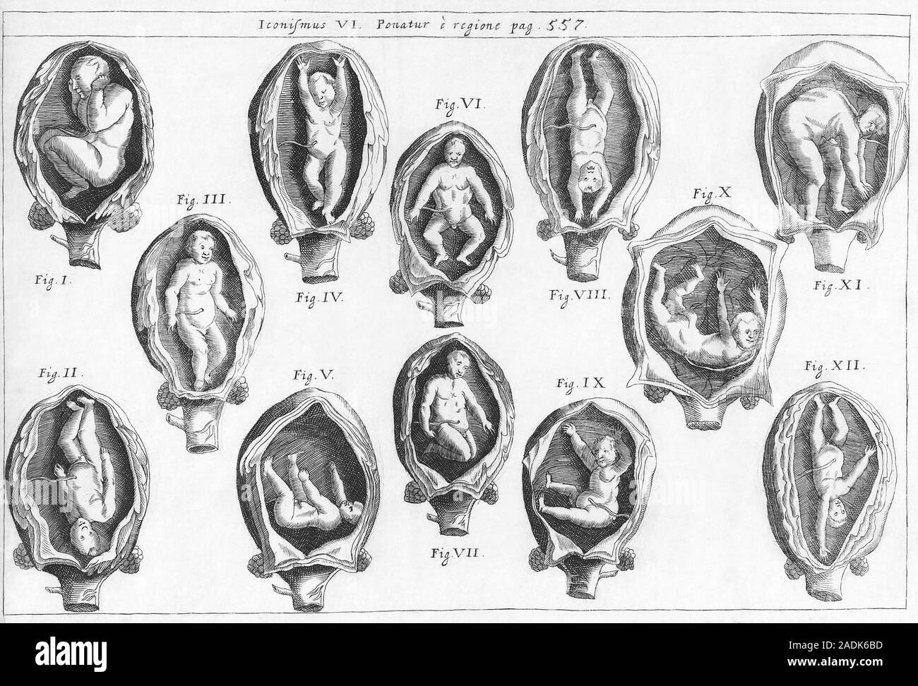 Birth presentations. Historical artwork of an assortment of possible ...