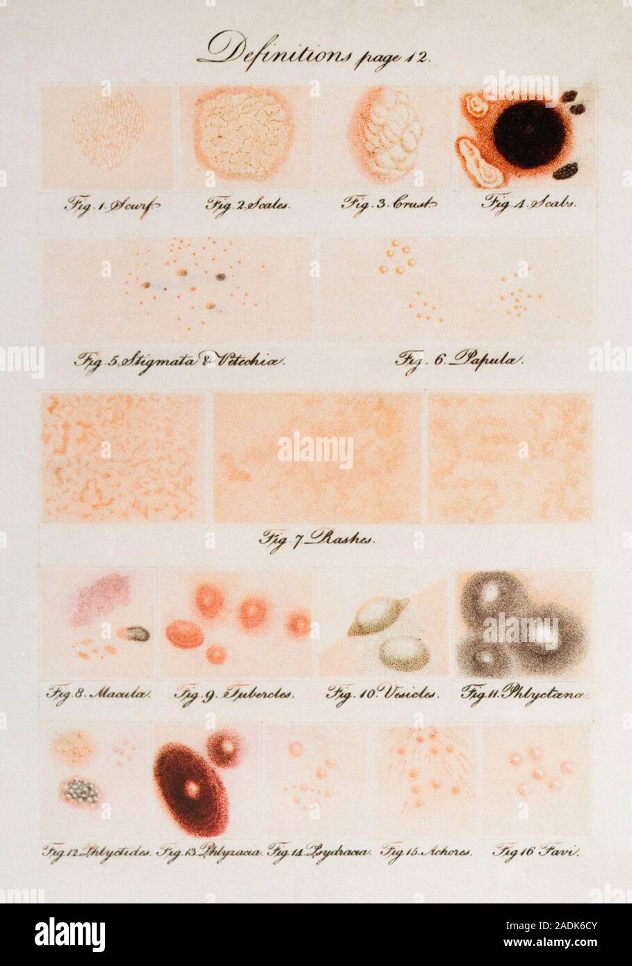 Skin lesions. Artwork from Robert Willan's 1808 medical textbook, On ...