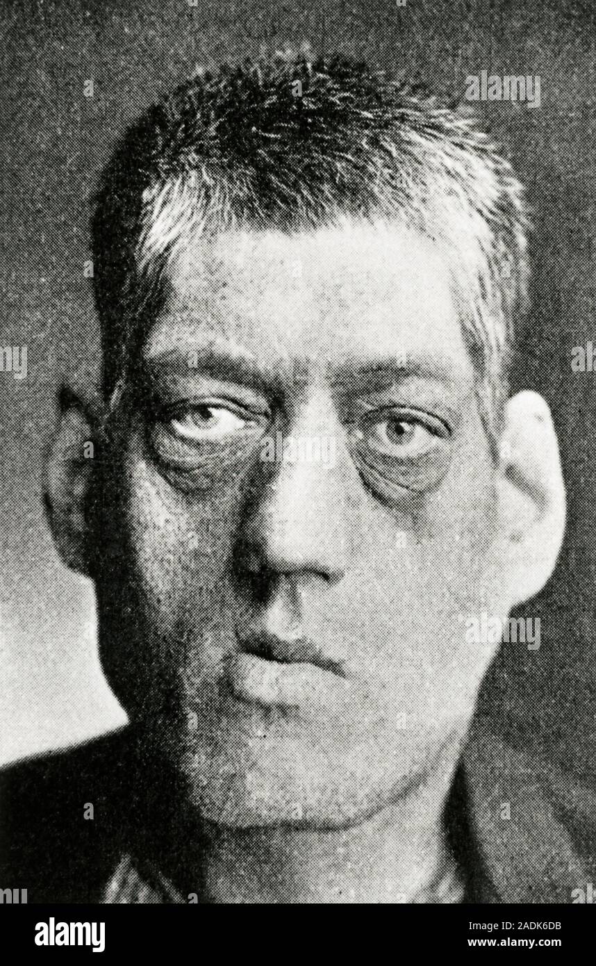 Acromegaly. Early photograph of the face of a man suffering from ...