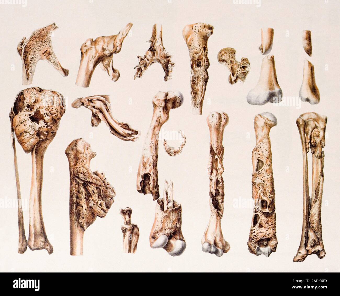 Diseased bones, historical anatomical artwork. Shown here is a range of ...