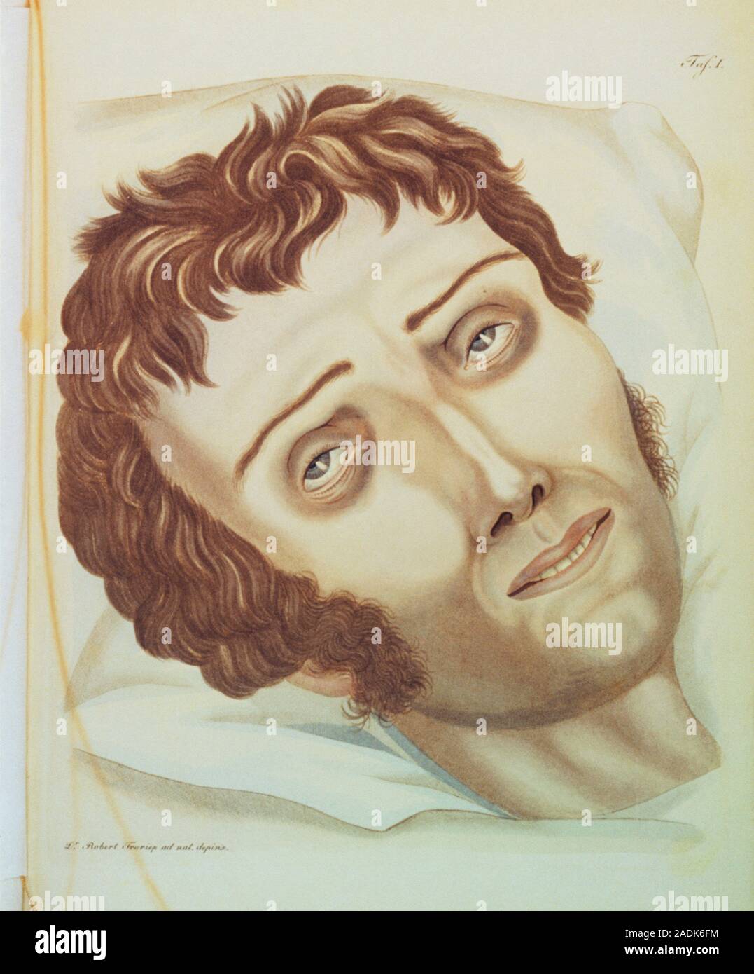 Illustration of the face of a patient affected by cholera taken from ...