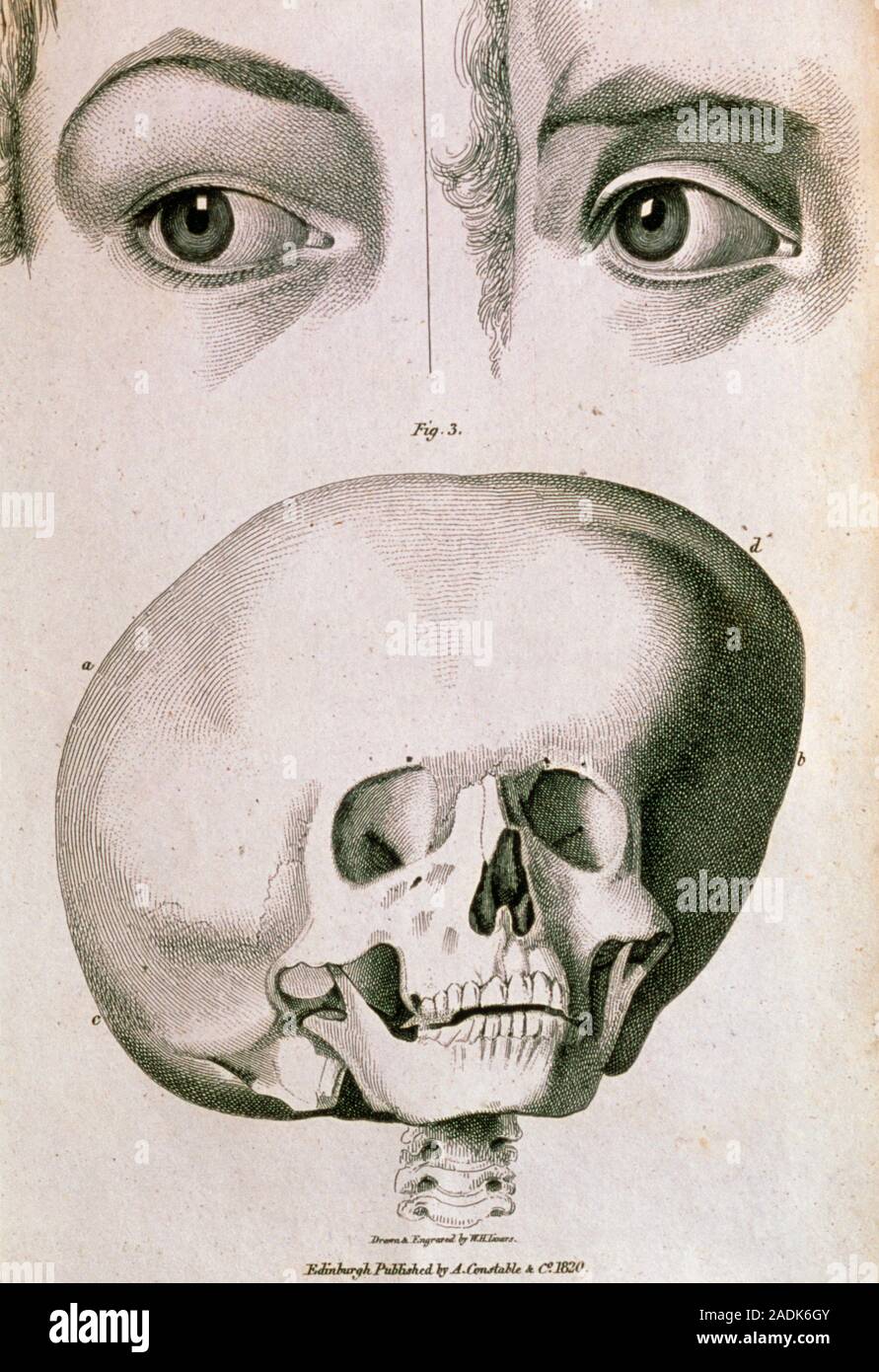 Hydrocephalic skull. Historical illustration of an enlarged ...