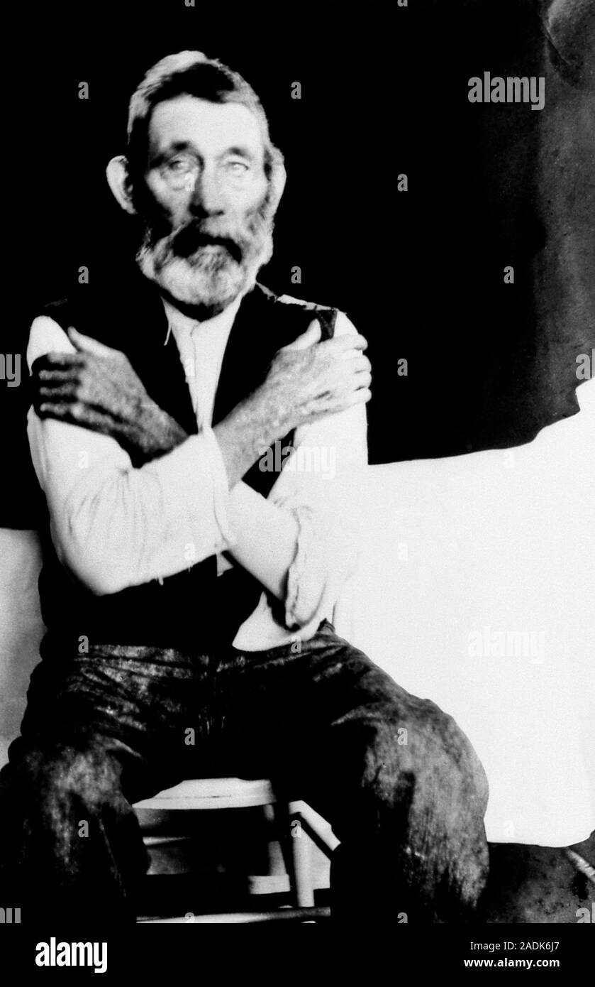 Plague victim. Male plague victim with his arms crossed. Plague is a ...