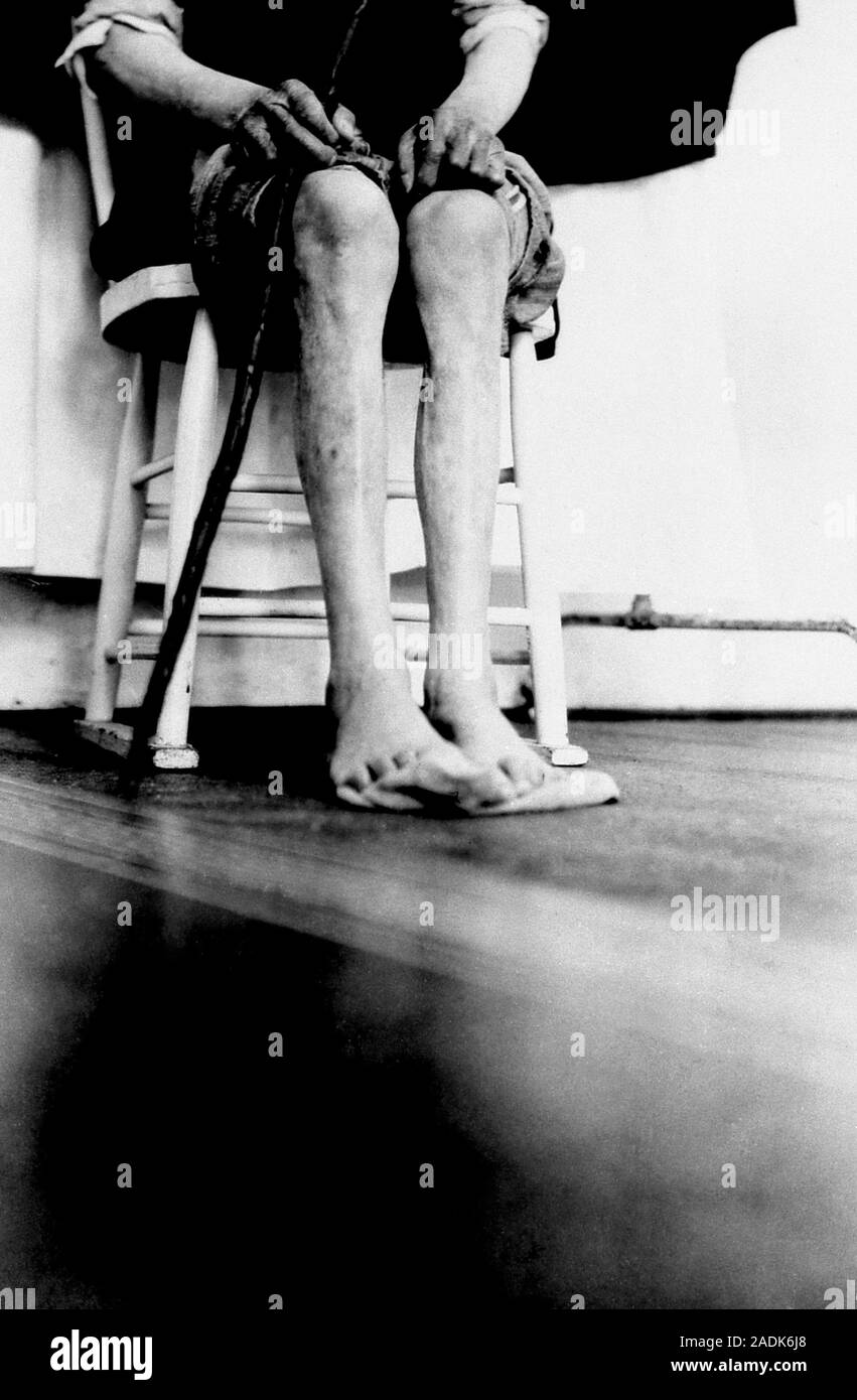 Plague victim. Male plague victim showing the effects of the disease on ...