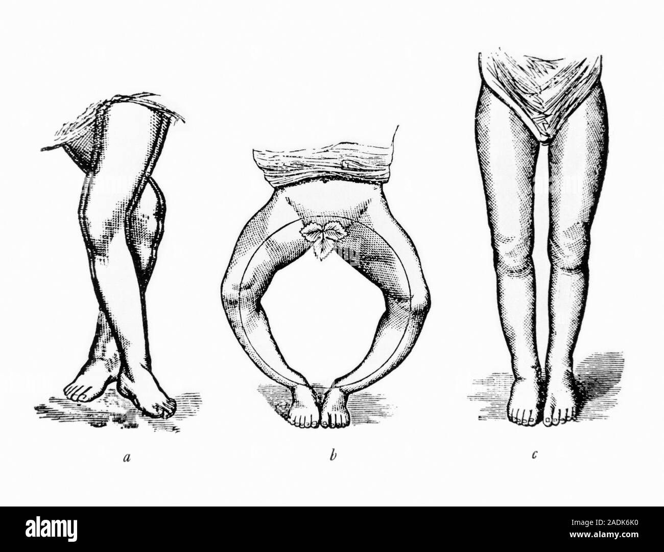 Rickets. Drawing of three pairs of legs (labelled 'a', 'b', 'c'). Pair ...
