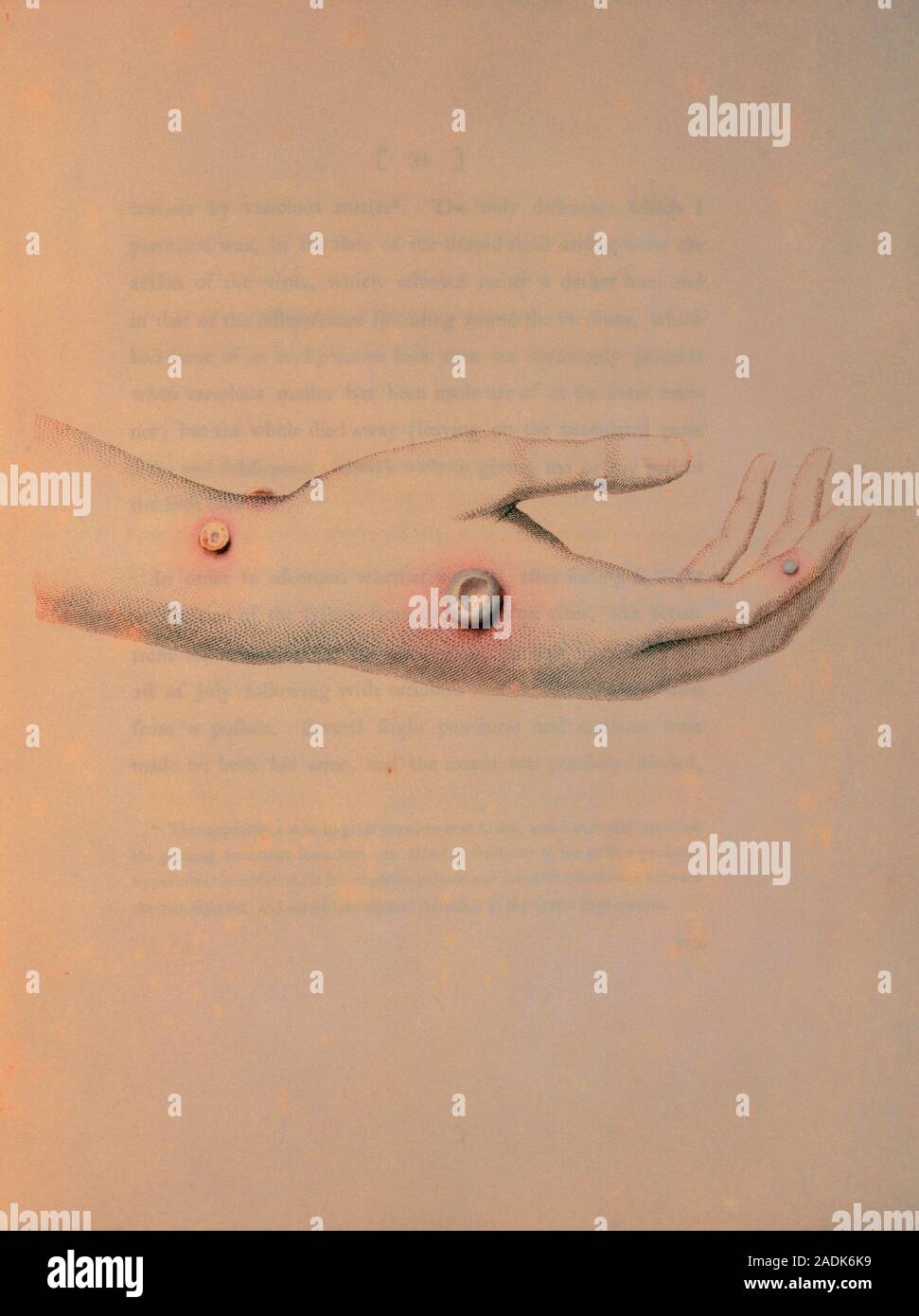 Pustules on the hand of a person with cowpox. The illustration is from ...