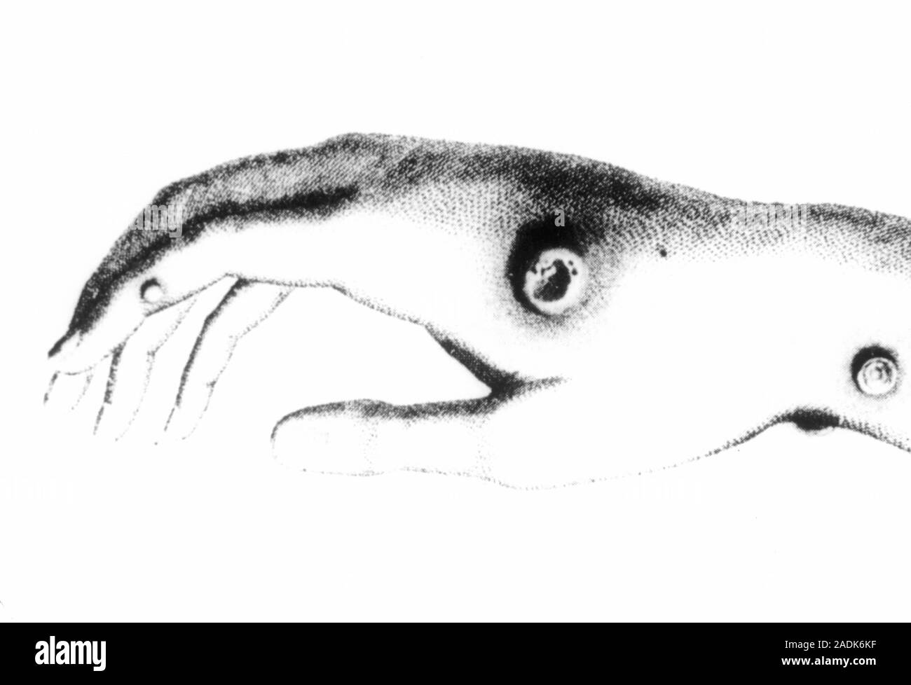 History of smallpox vaccination. Illustration showing cowpox lesions on ...