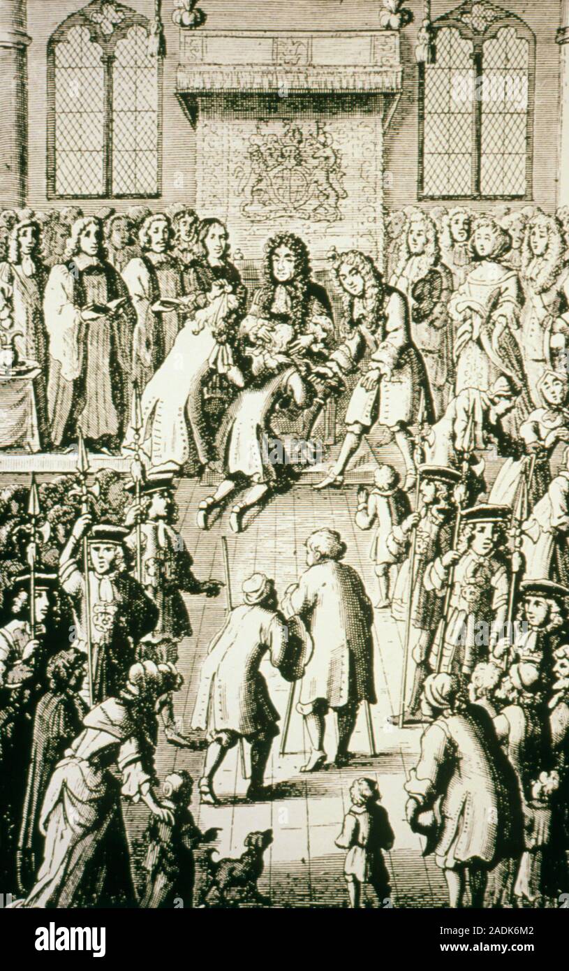 Illustration of the English King Charles II touching patients to cure ...