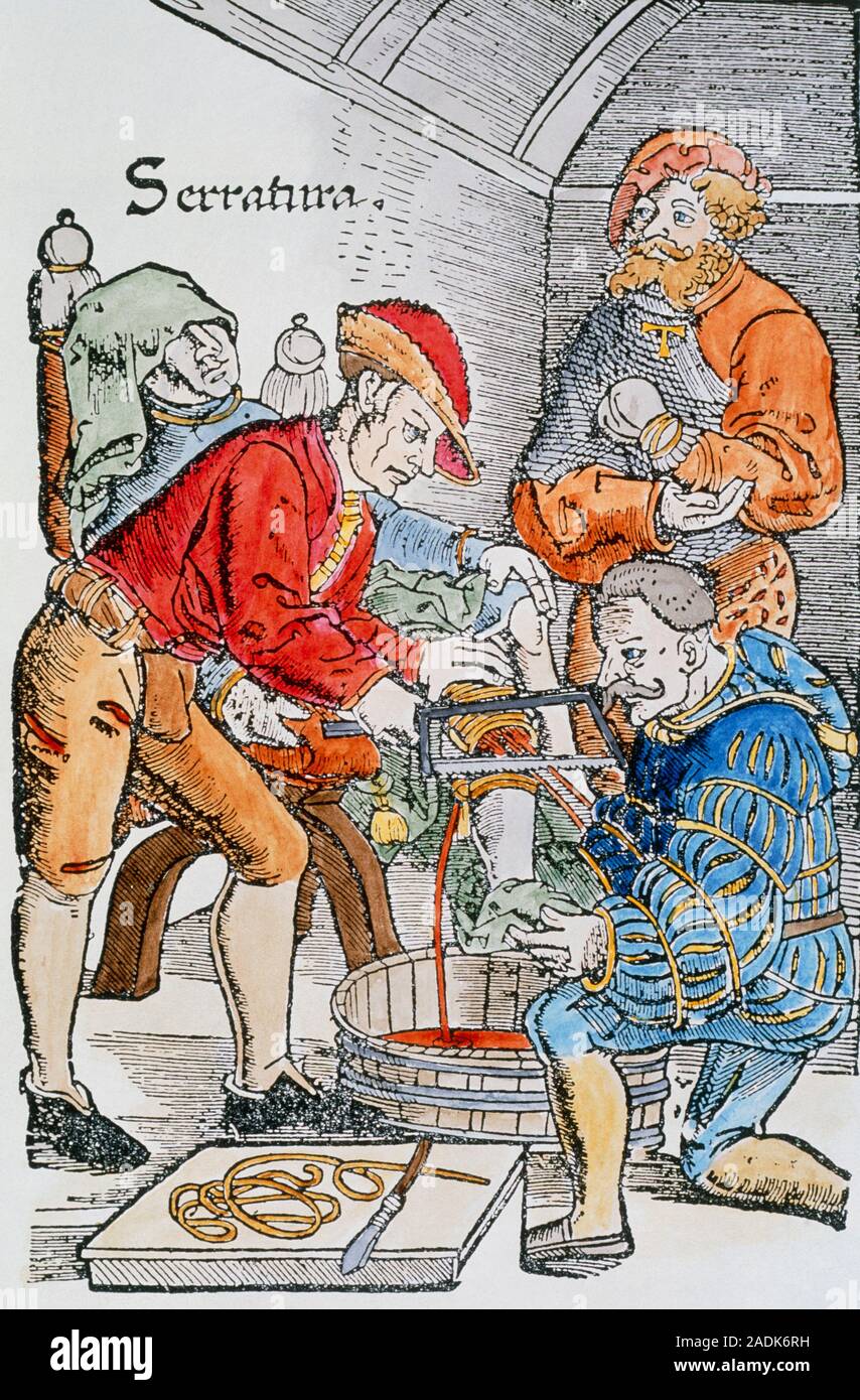 Leg amputation. Illustration of a leg amputation in the 16th century ...