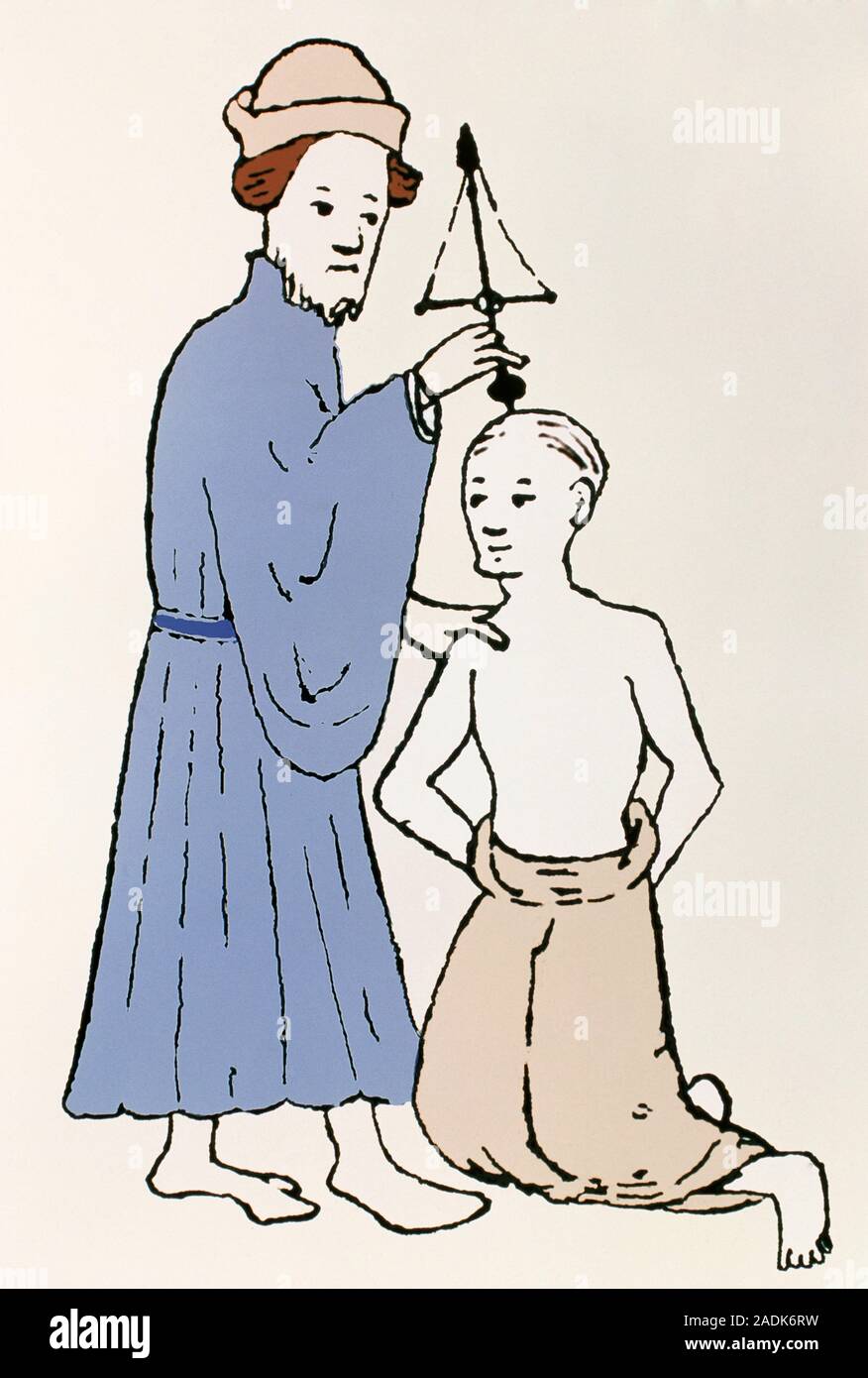 Trephining. Coloured 13th century artwork showing trephining, the ...