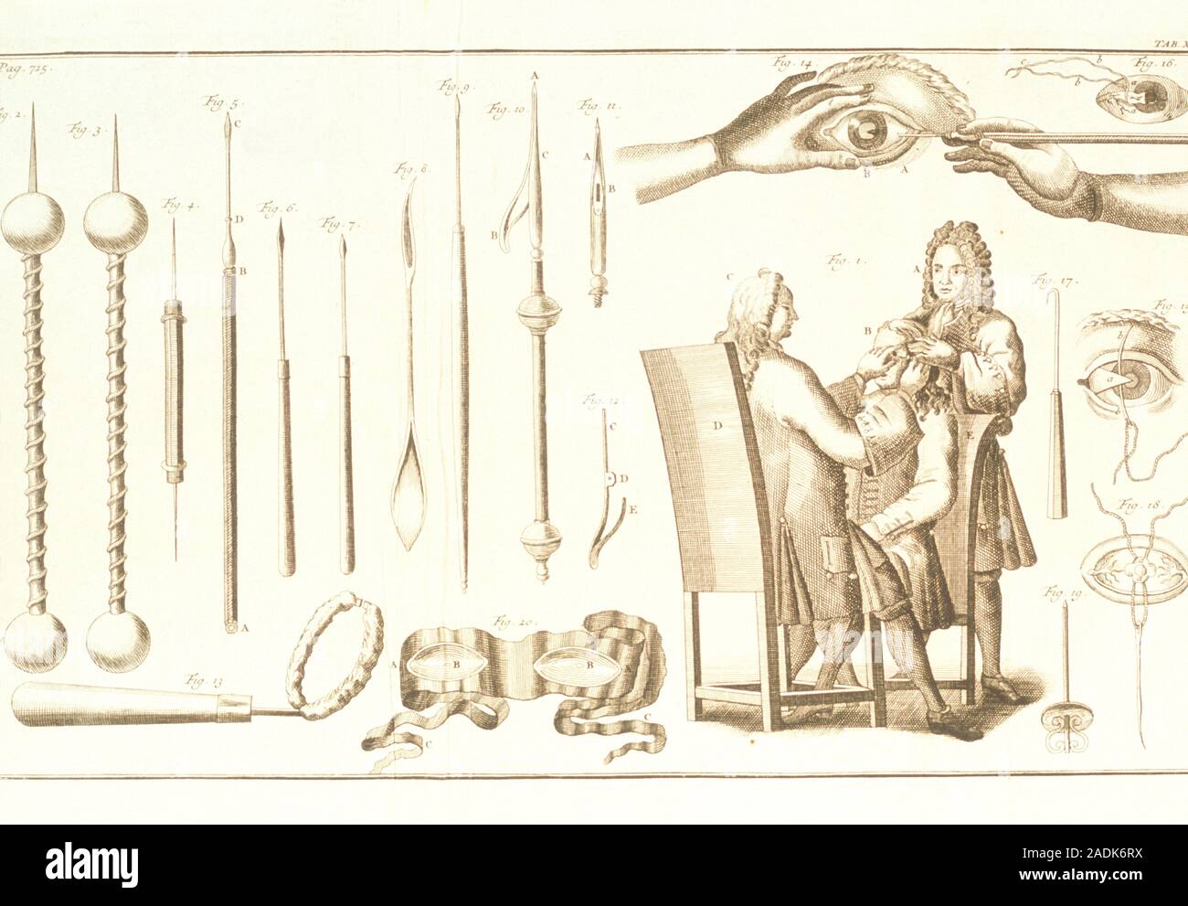 Eye surgery. Historical engraving of surgeons performing eye surgery ...