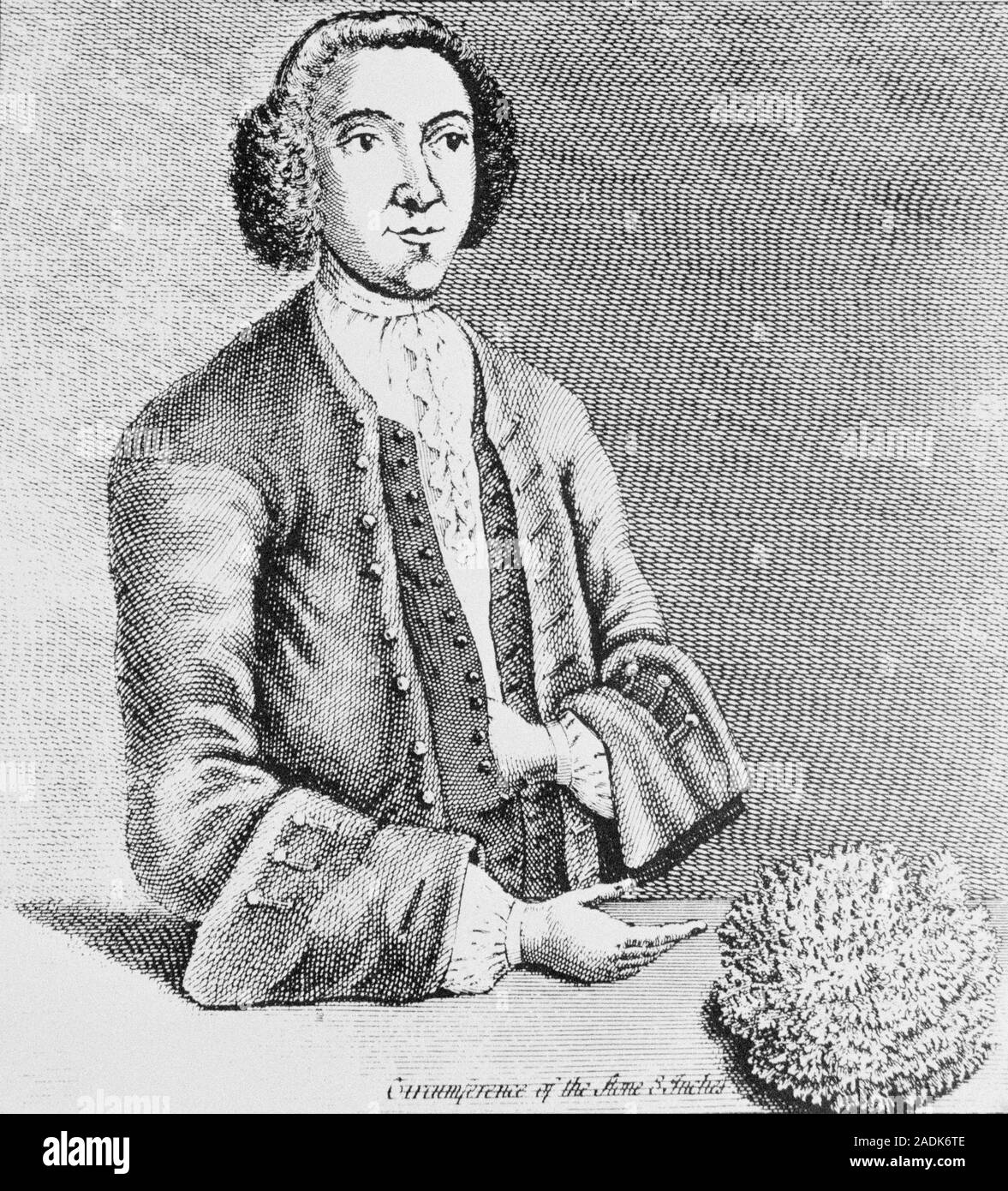 Bladder stone. Historical engraving of a young male lithotomy patient ...