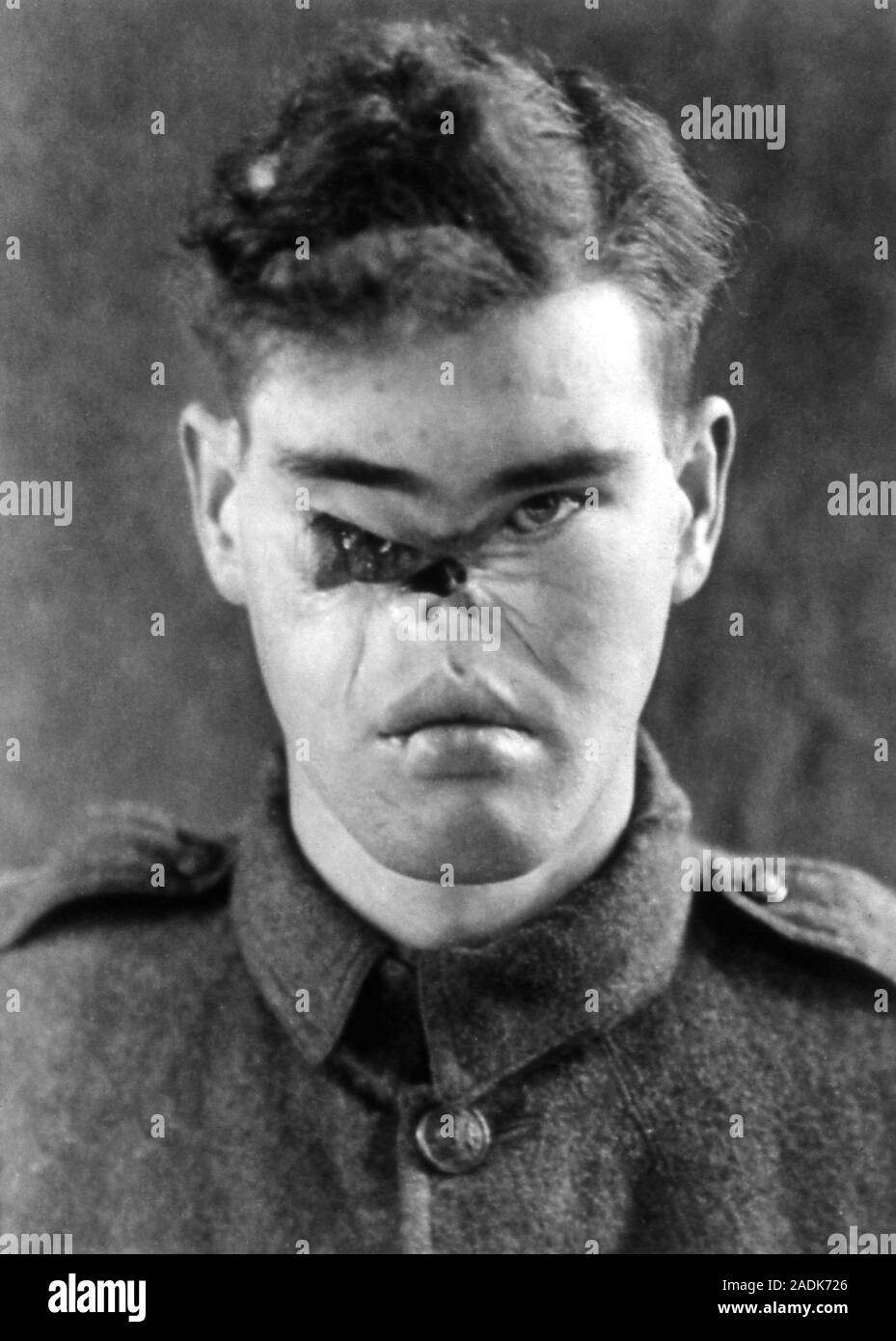 Facial wound on a World War I soldier. Man left disfigured after an ...