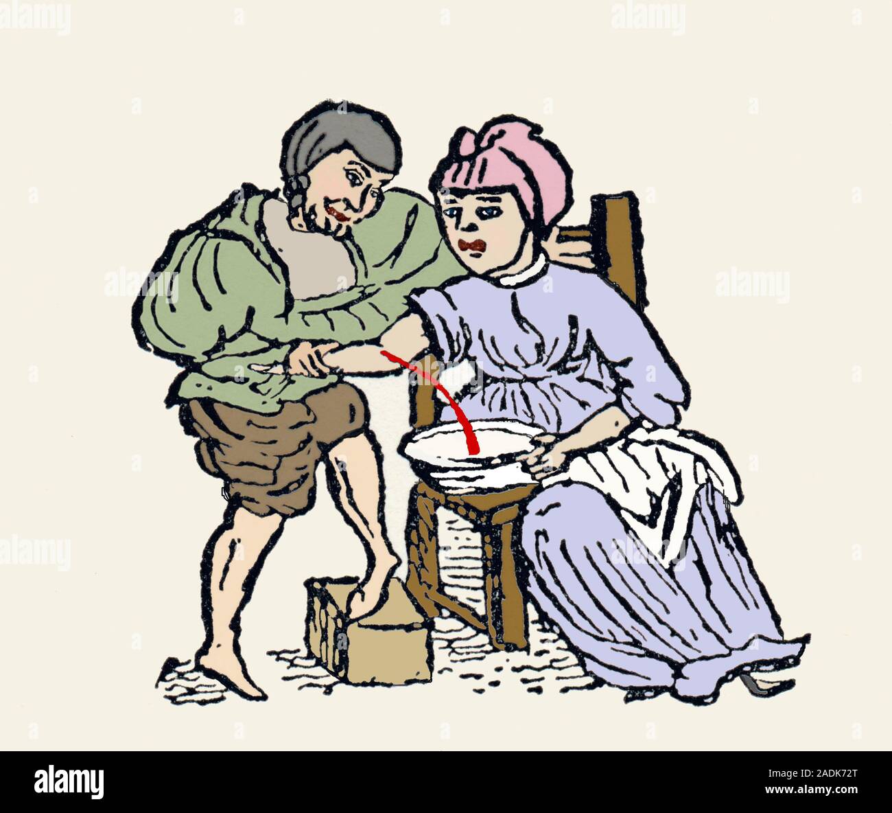 Bloodletting, coloured historical artwork. This woodcut is from the ...