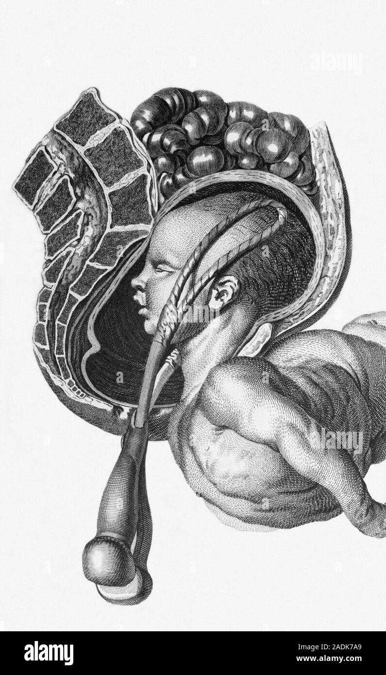 Delivery of baby using forceps. Artwork taken from William Smellie's ...