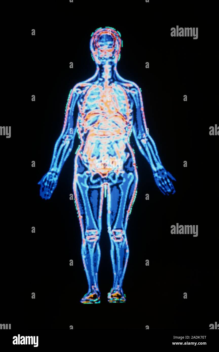 Coloured computed tomography (CT) scan showing a normal human, female ...
