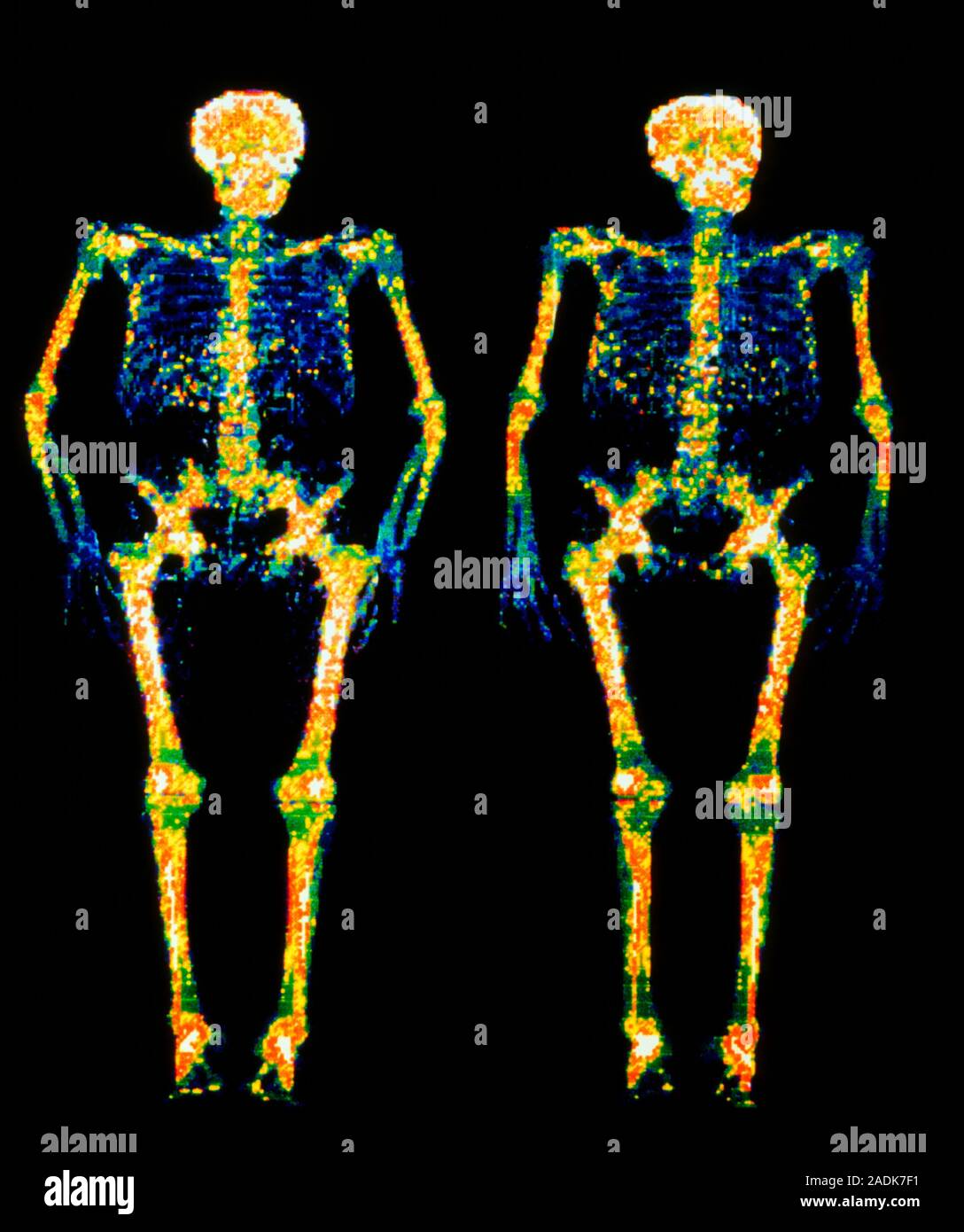 Bone density scans. Coloured bone densitometry (Lunar DPX) scans of the ...