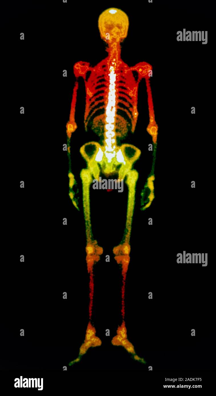 Human skeleton. Coloured gamma scan (scintigram) of a healthy human ...