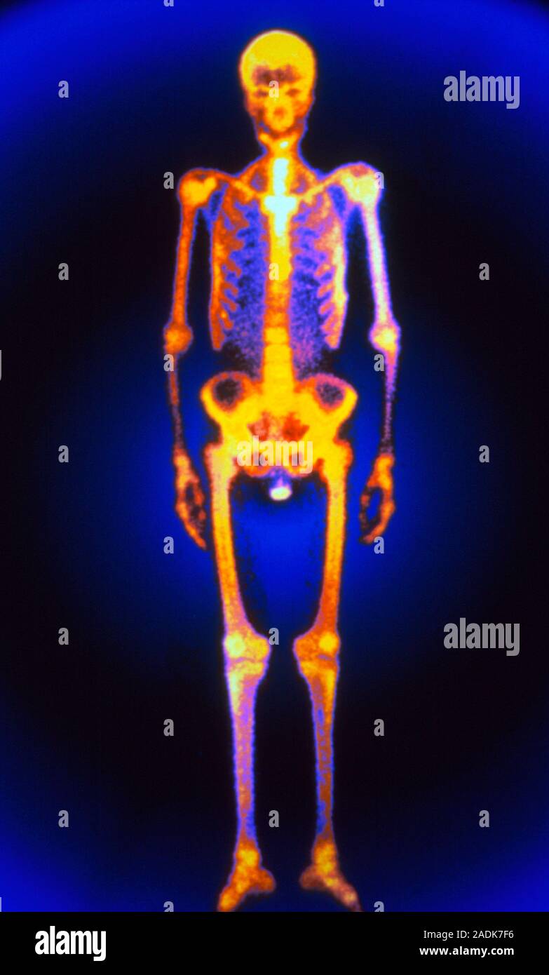 Human skeleton. Coloured gamma scan (scintigram) of a healthy human ...