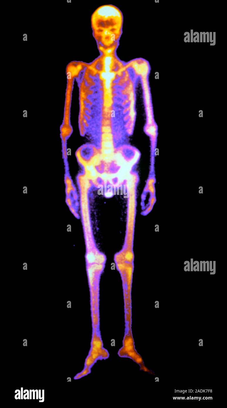 Human skeleton. Coloured gamma scan (scintigram) of a healthy human ...