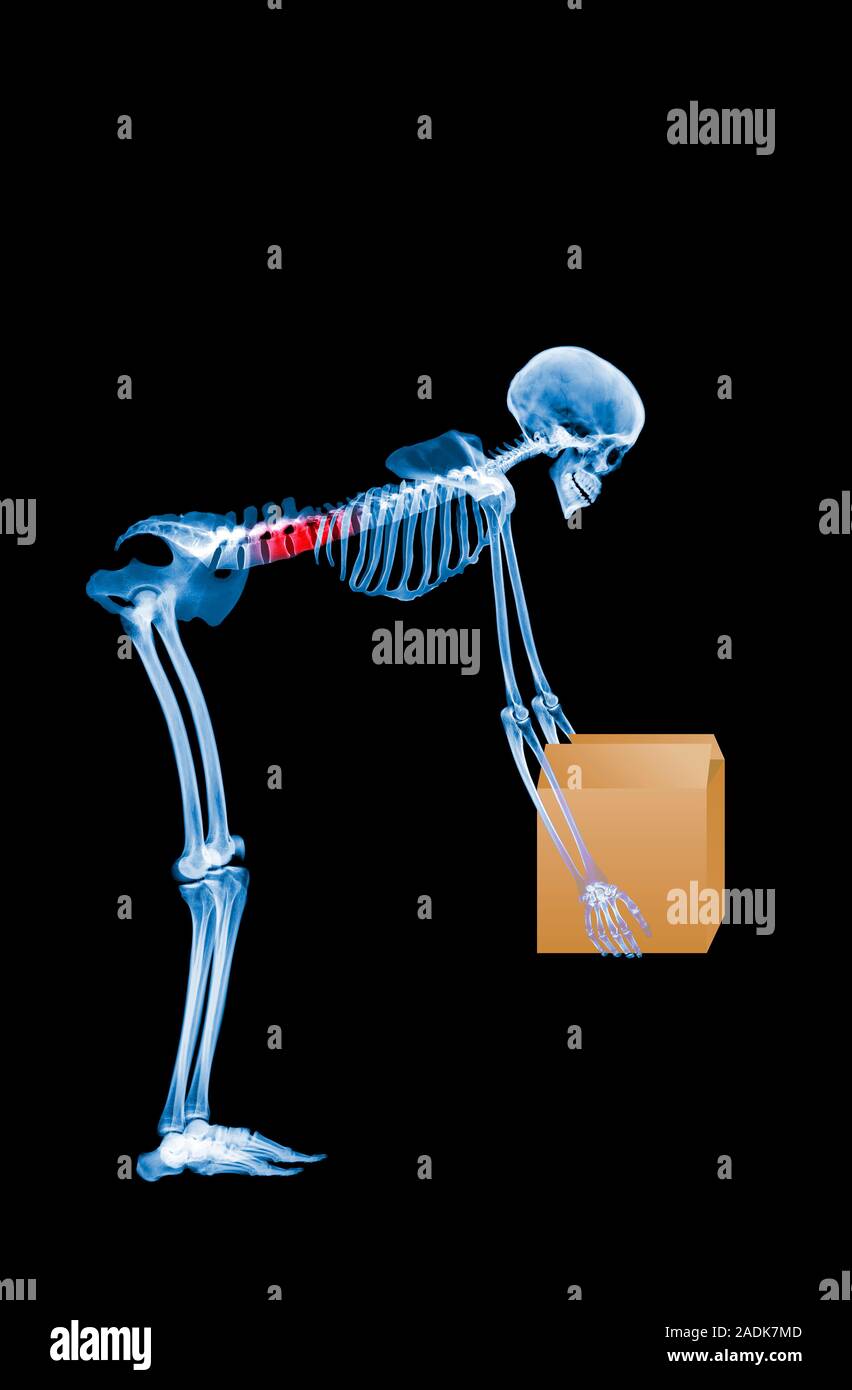 Skeleton lifting a box incorrectly. Side view X- ray. This image shows ...