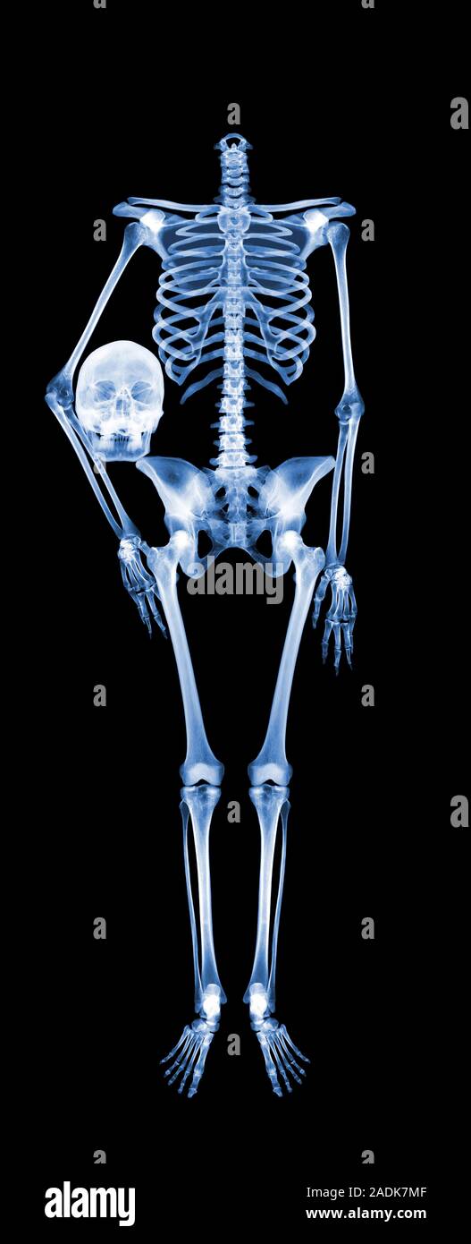 Headless skeleton. X-ray of a skeleton holding its head under its arm ...