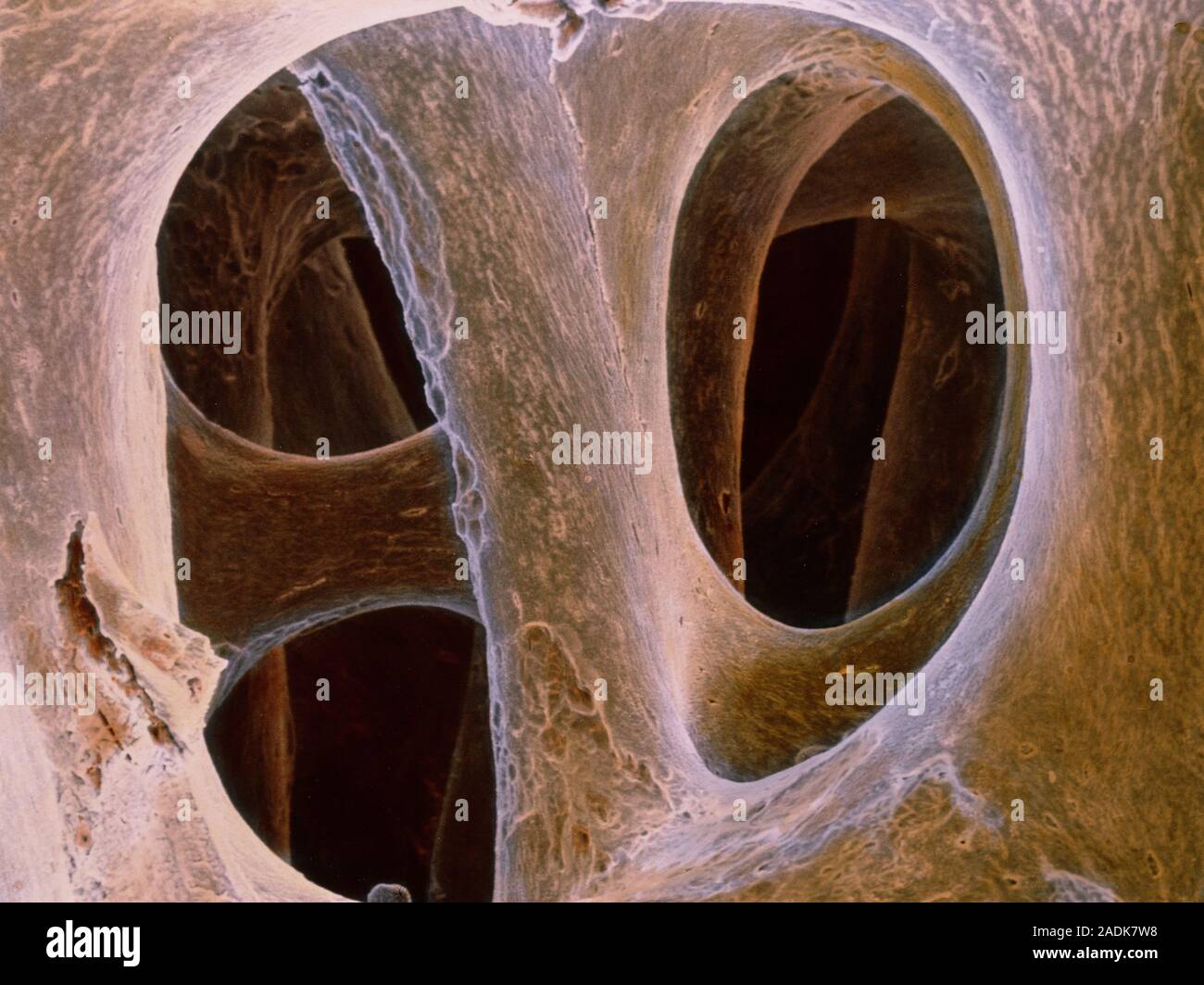 Cancellous bone. False-colour scanning electron micrograph (SEM) of ...