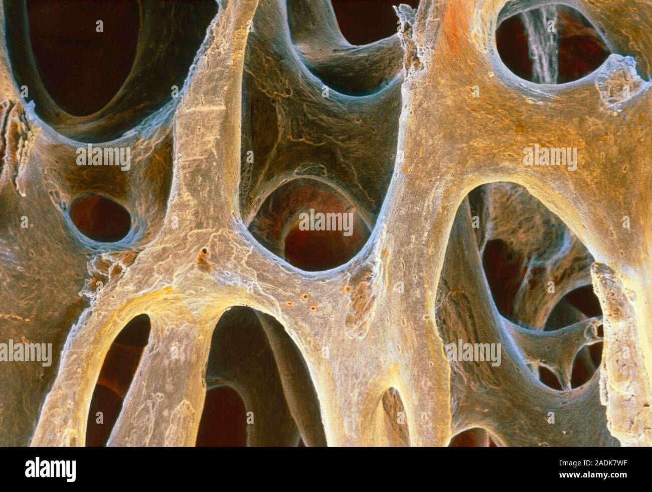 Cancellous bone. False-colour scanning electron micrograph of ...