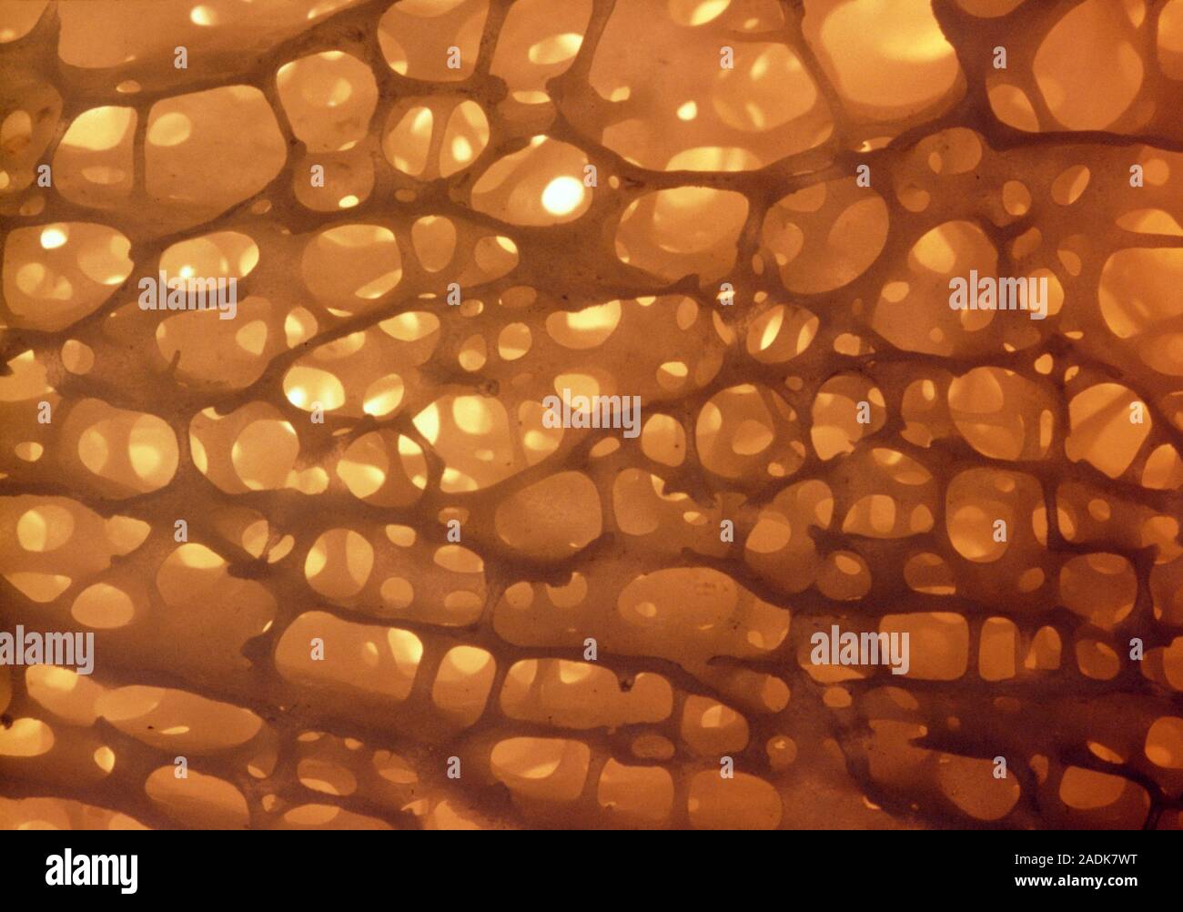 Cancellous bone. Close-up of normal cancellous (spongy) bone from a ...