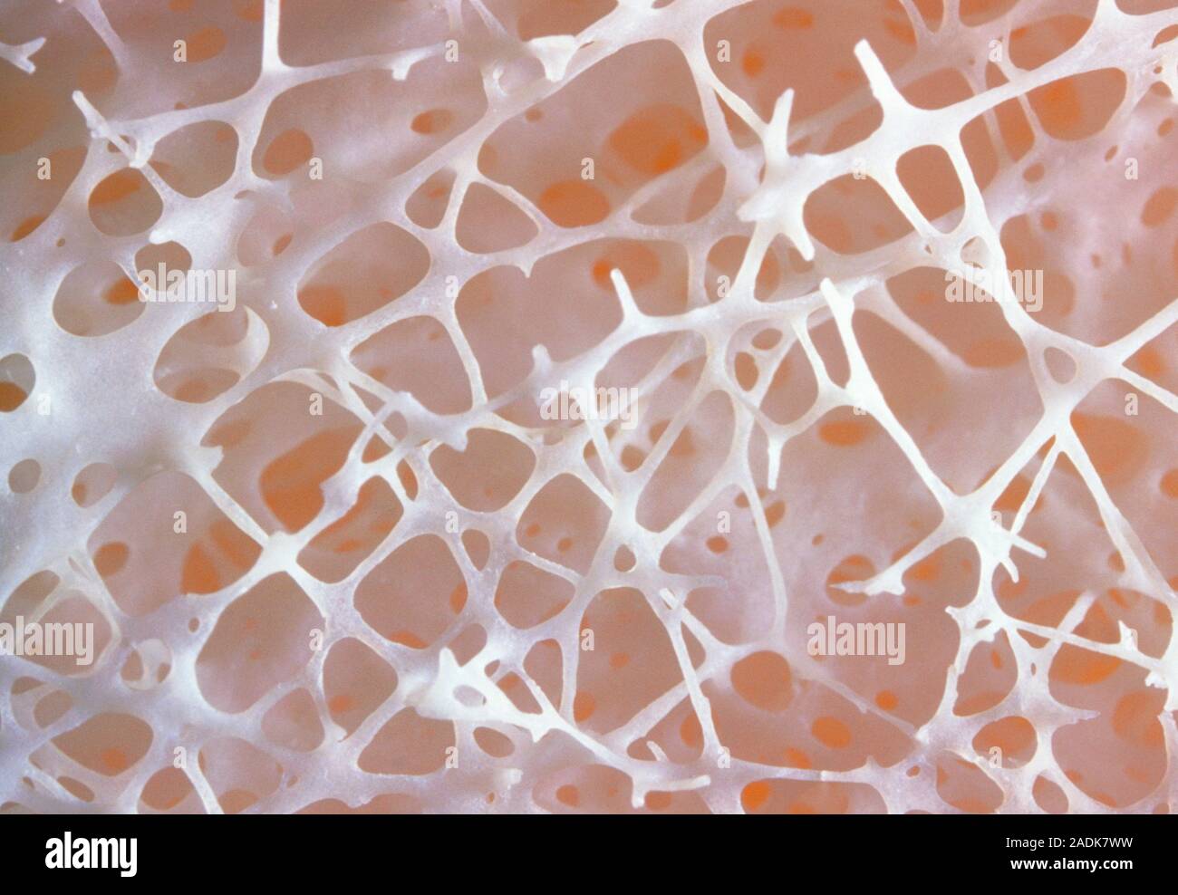 Spongy bone. Macrophotograph of normal spongy bone from a human femur ...