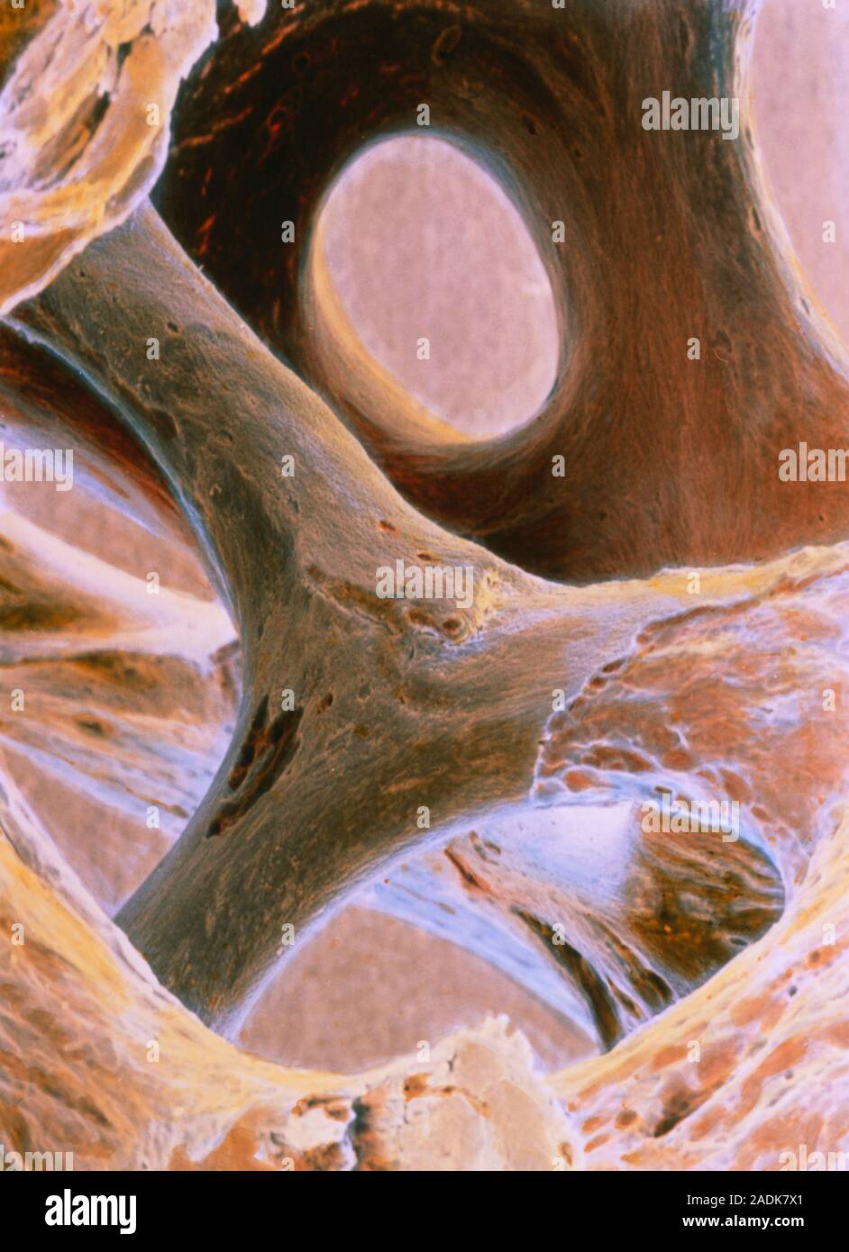 Human bone. Coloured scanning electron micrograph of trabeculae in ...