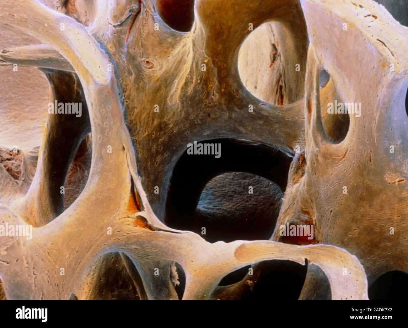 Human bone. Coloured scanning electron micrograph of trabeculae in ...