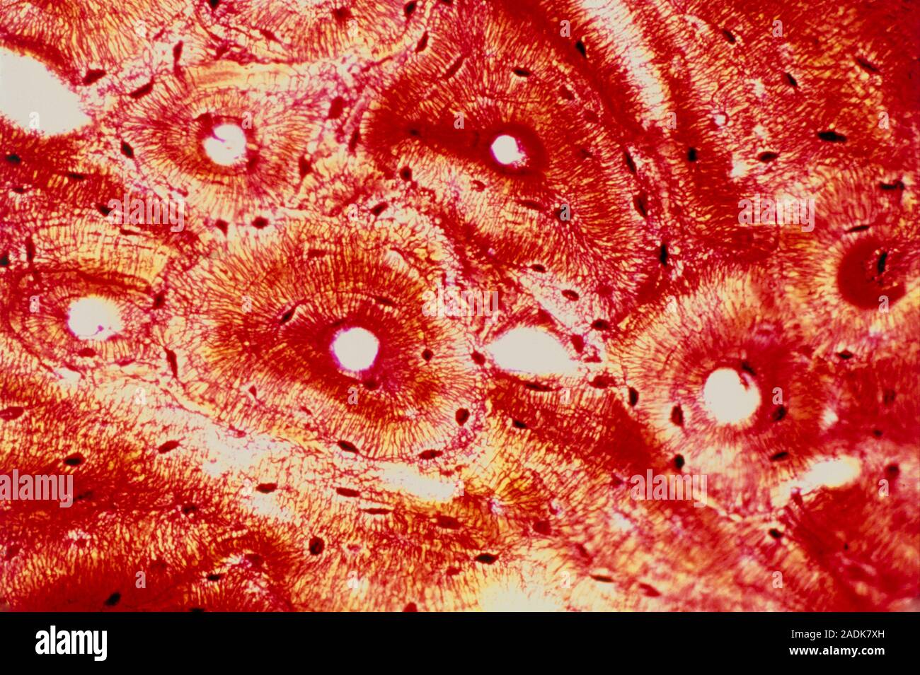 Compact bone. Light micrograph of human compact bone. This type of bone ...