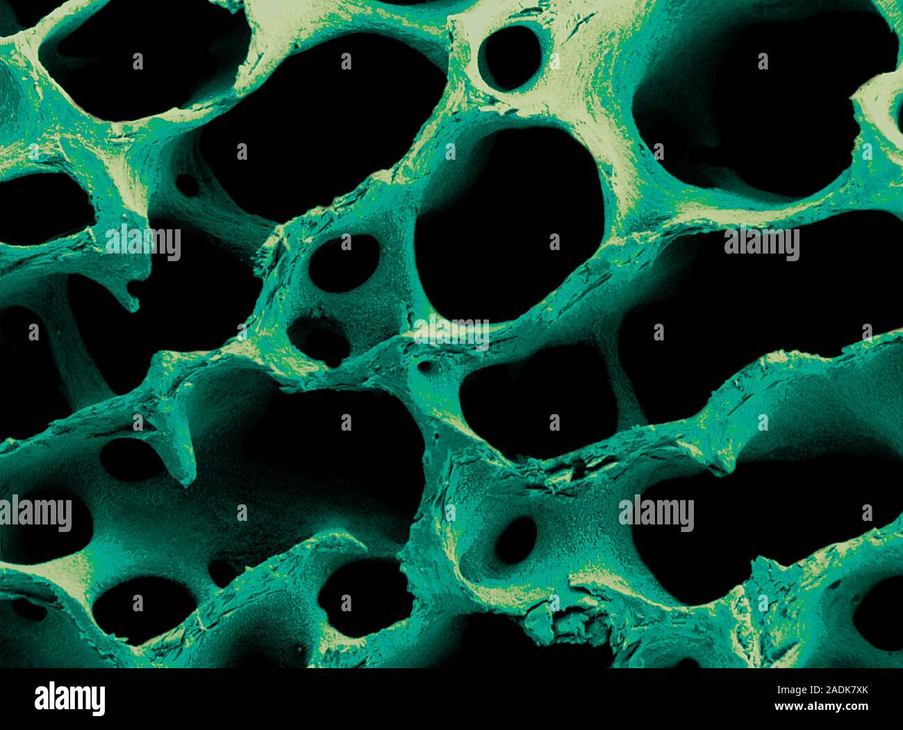 Spongy bone. Coloured scanning electron micrograph (SEM) of human ...