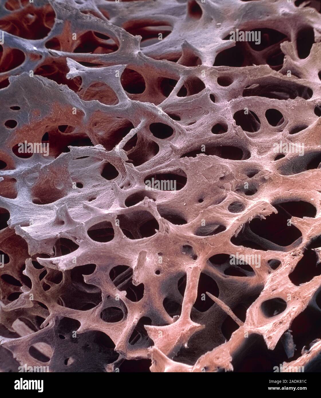 Spongy bone. Coloured scanning electron micrograph (SEM) of human ...