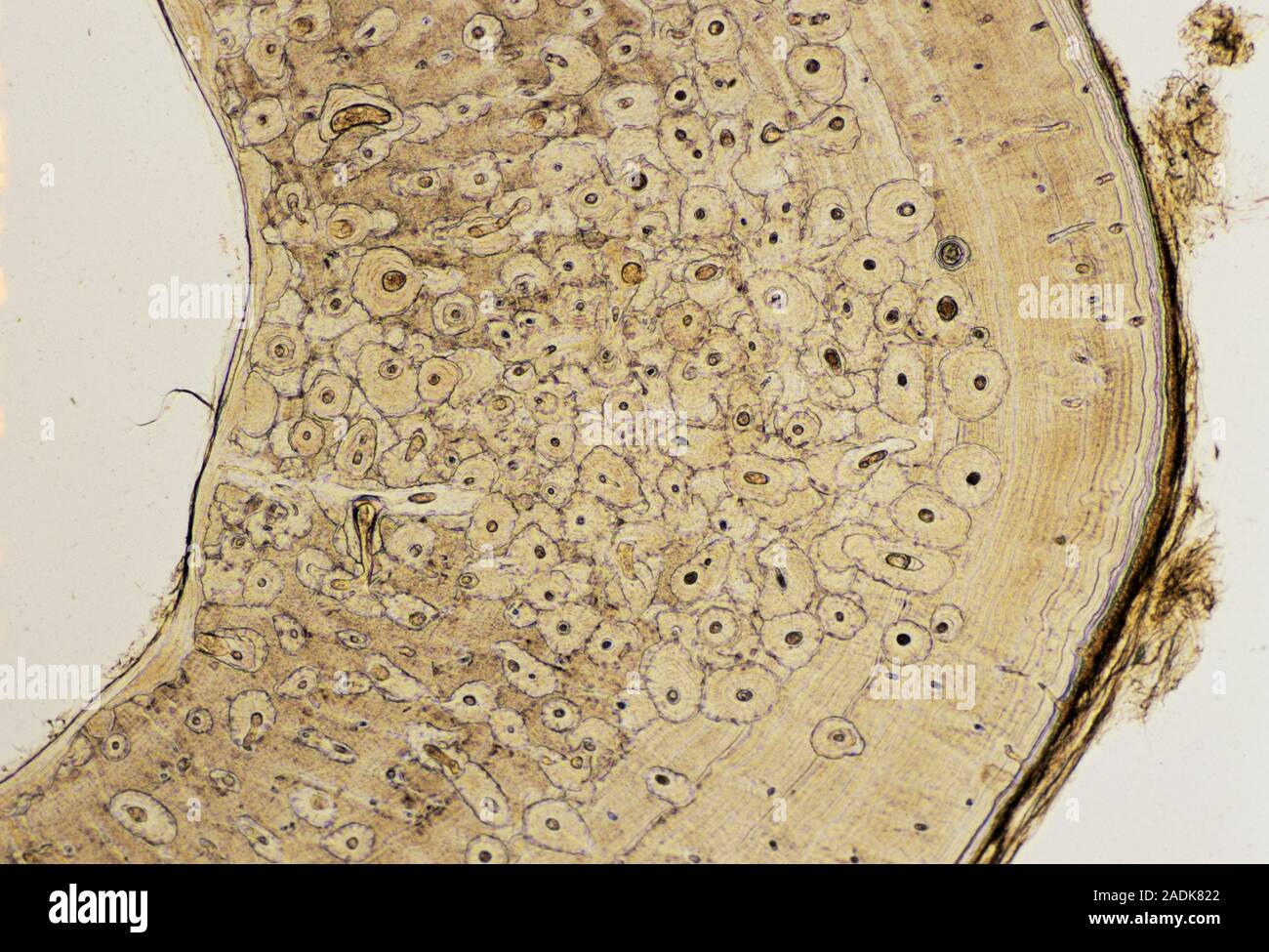 Compact bone. Light micrograph of a cross-section through a femur, the ...