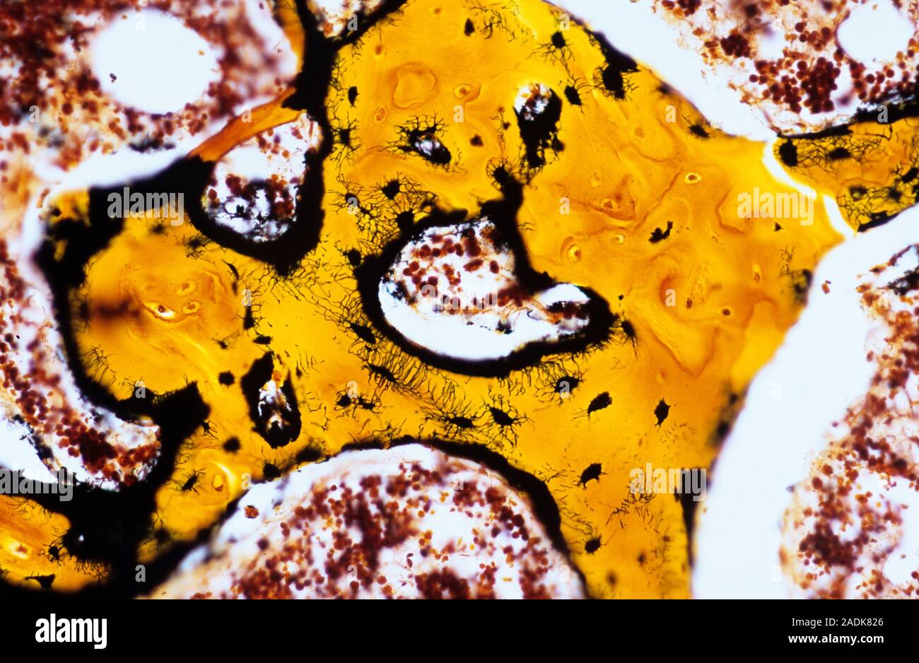 Spongy bone. Light micrograph of a section through spongy (cancellous ...