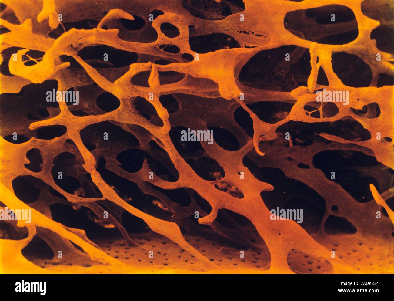 Spongy bone tissue, coloured scanning electron micrograph (SEM). Spongy ...